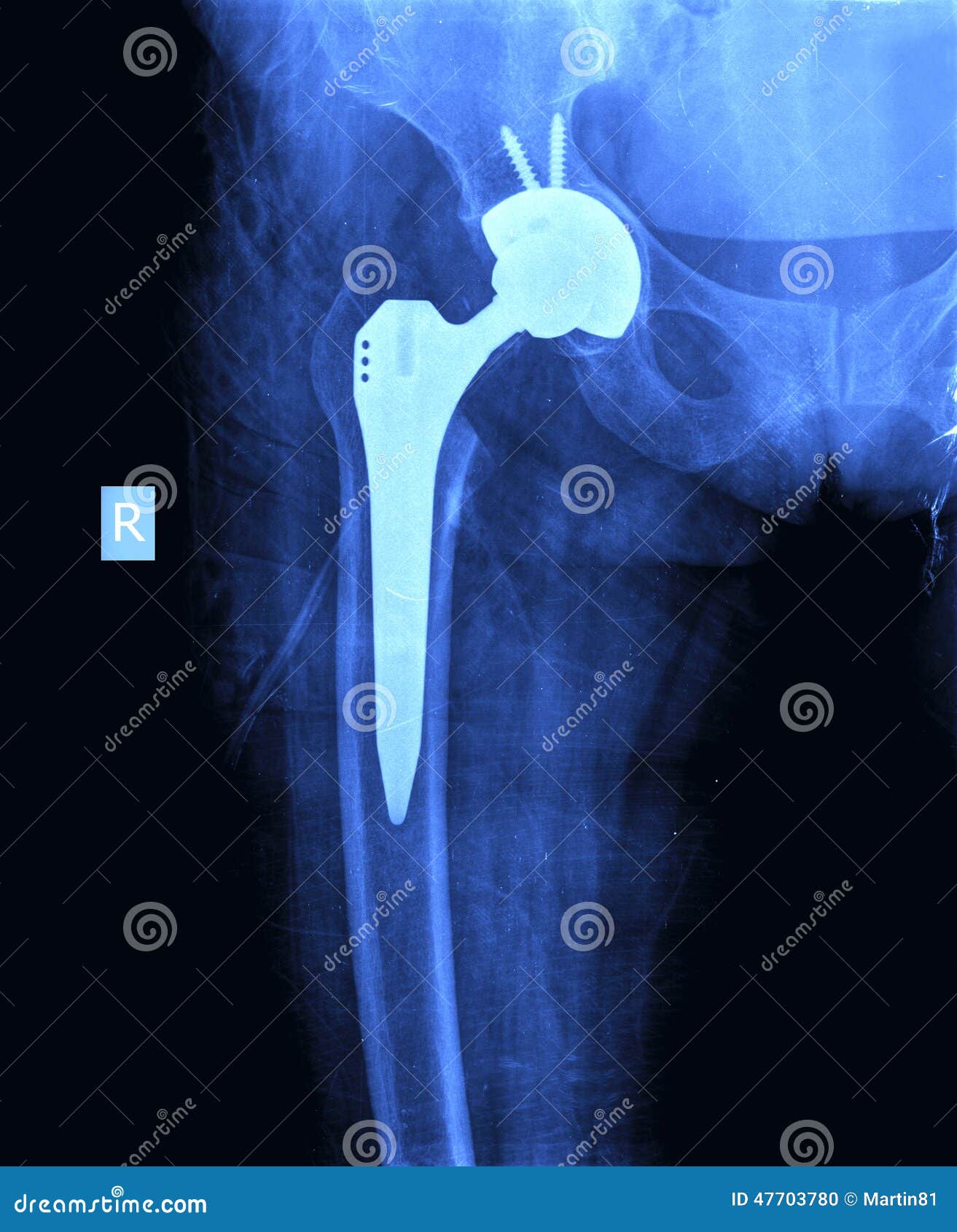 X-ray of hip prosthesis stock photo. Image of endoprothese - 47703780