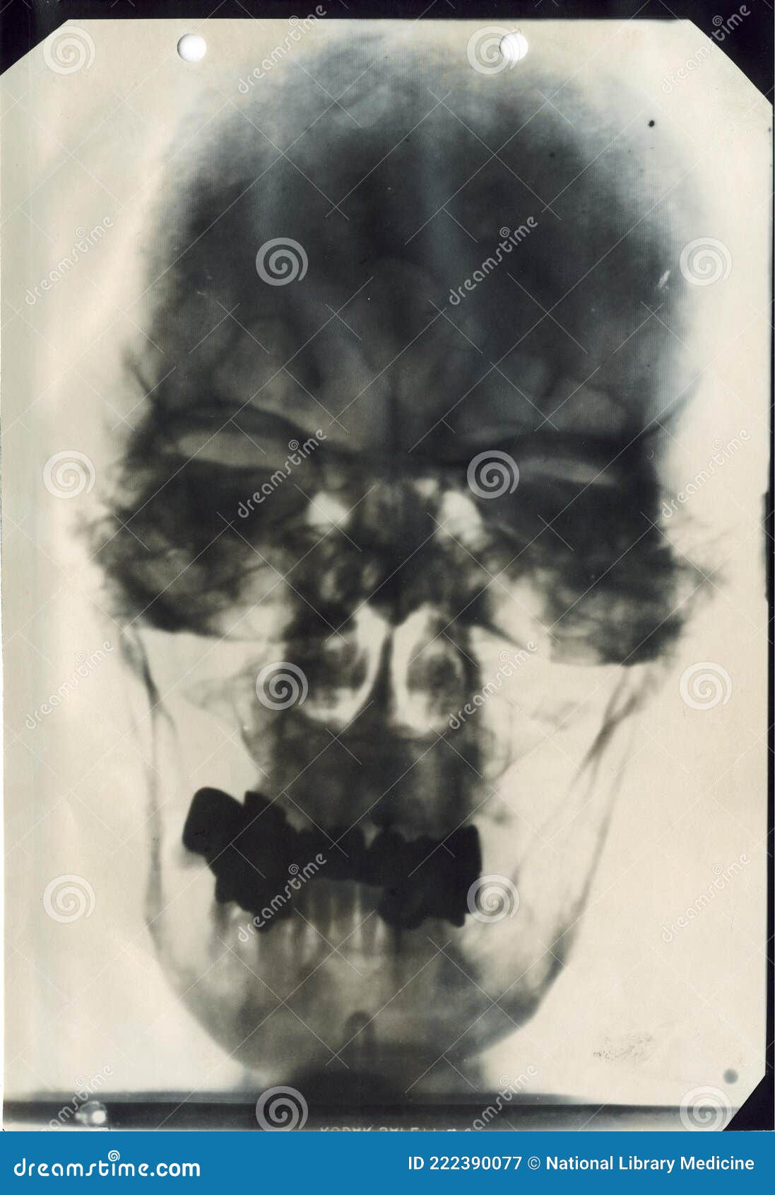 X-ray Of Hitler's Head Picture. Image: 222390077