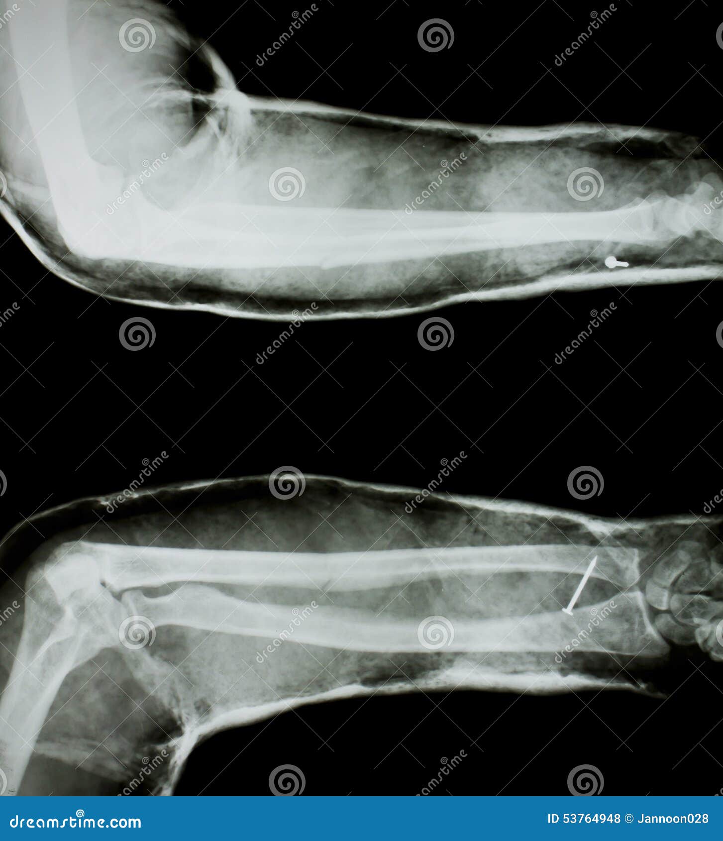 X-ray of human arm stock photo. Image of patient, backbone - 53764948