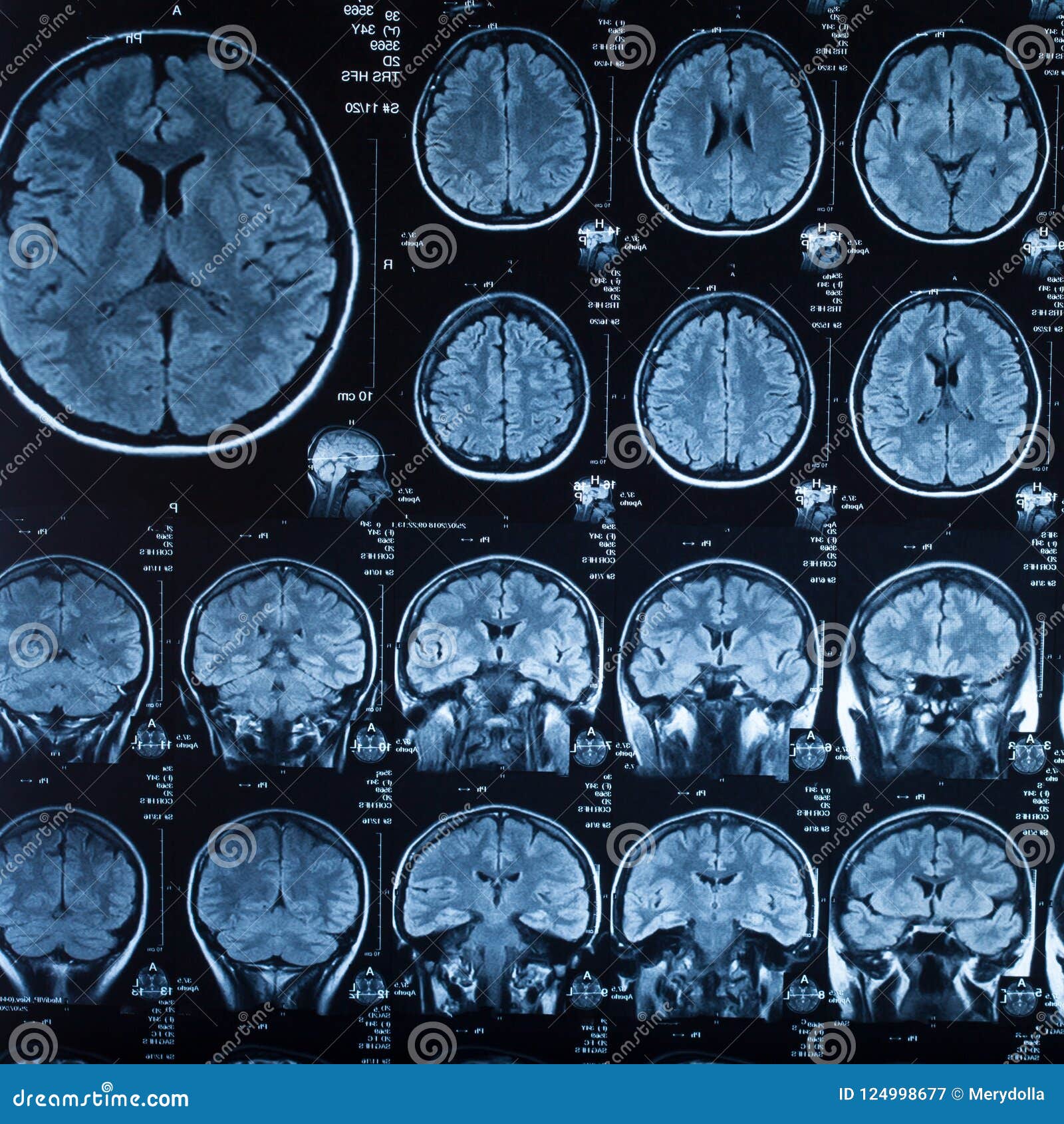 The X-ray of the Human Brain Stock Image - Image of human, healthcare ...