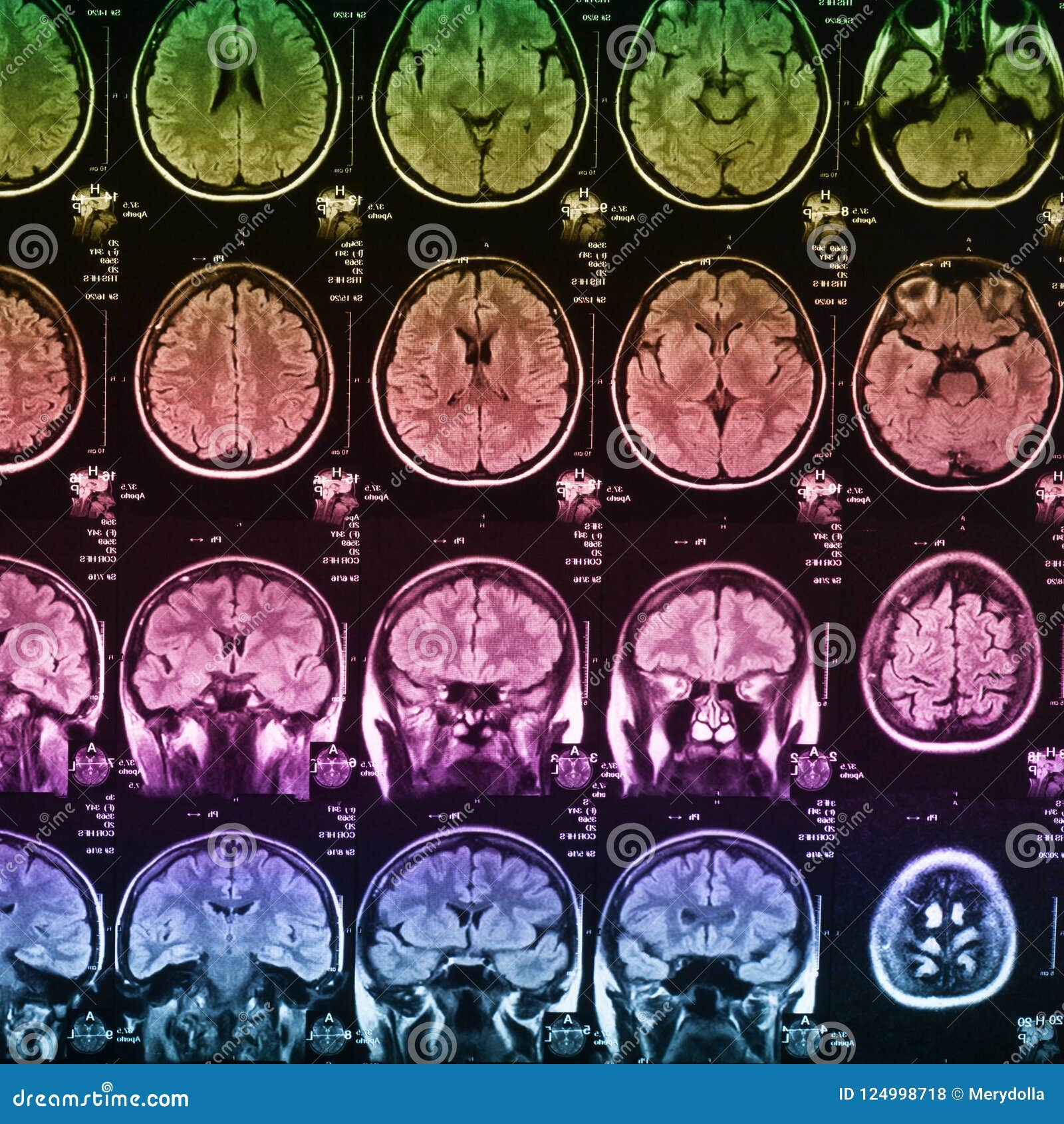 The X-ray of the Human Brain Stock Photo - Image of xray, radiology ...