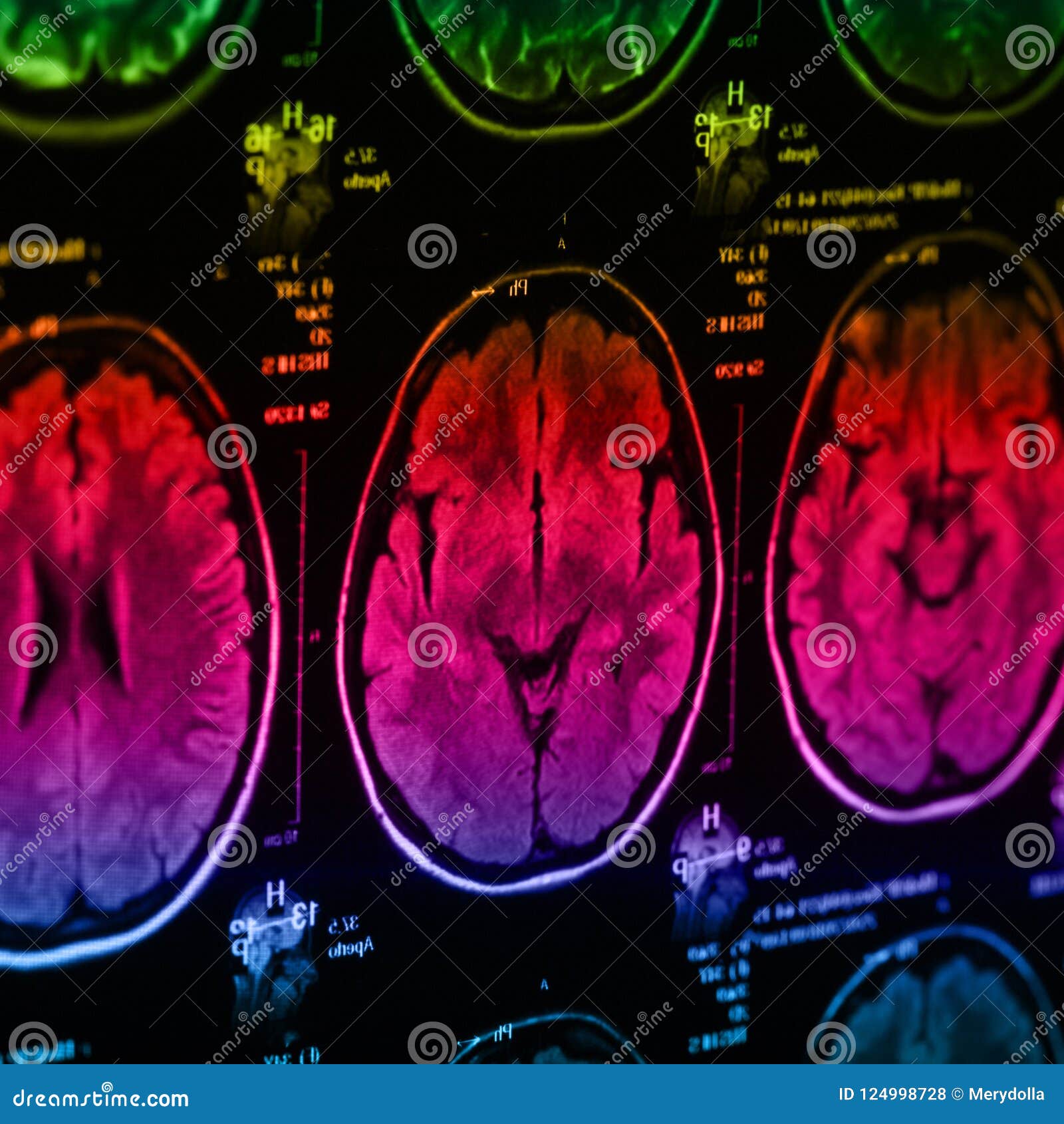 The X-ray of the Human Brain Stock Photo - Image of head, scan: 124998728