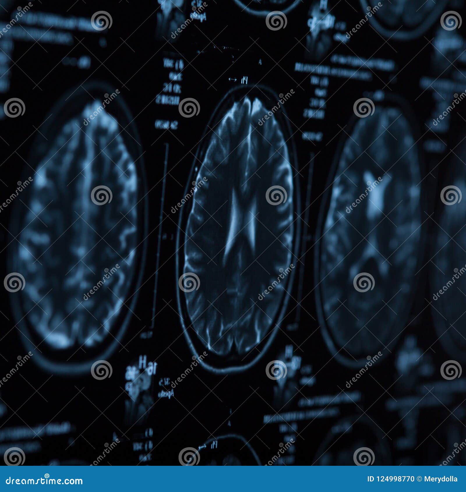 The X-ray of the Human Brain Stock Photo - Image of medical, human ...