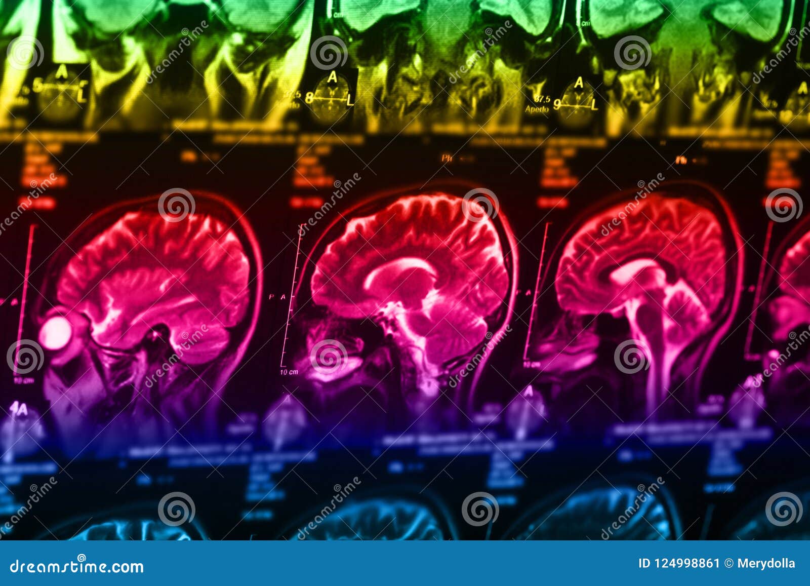 The X-ray of the Human Brain Stock Image - Image of neurology, scan ...