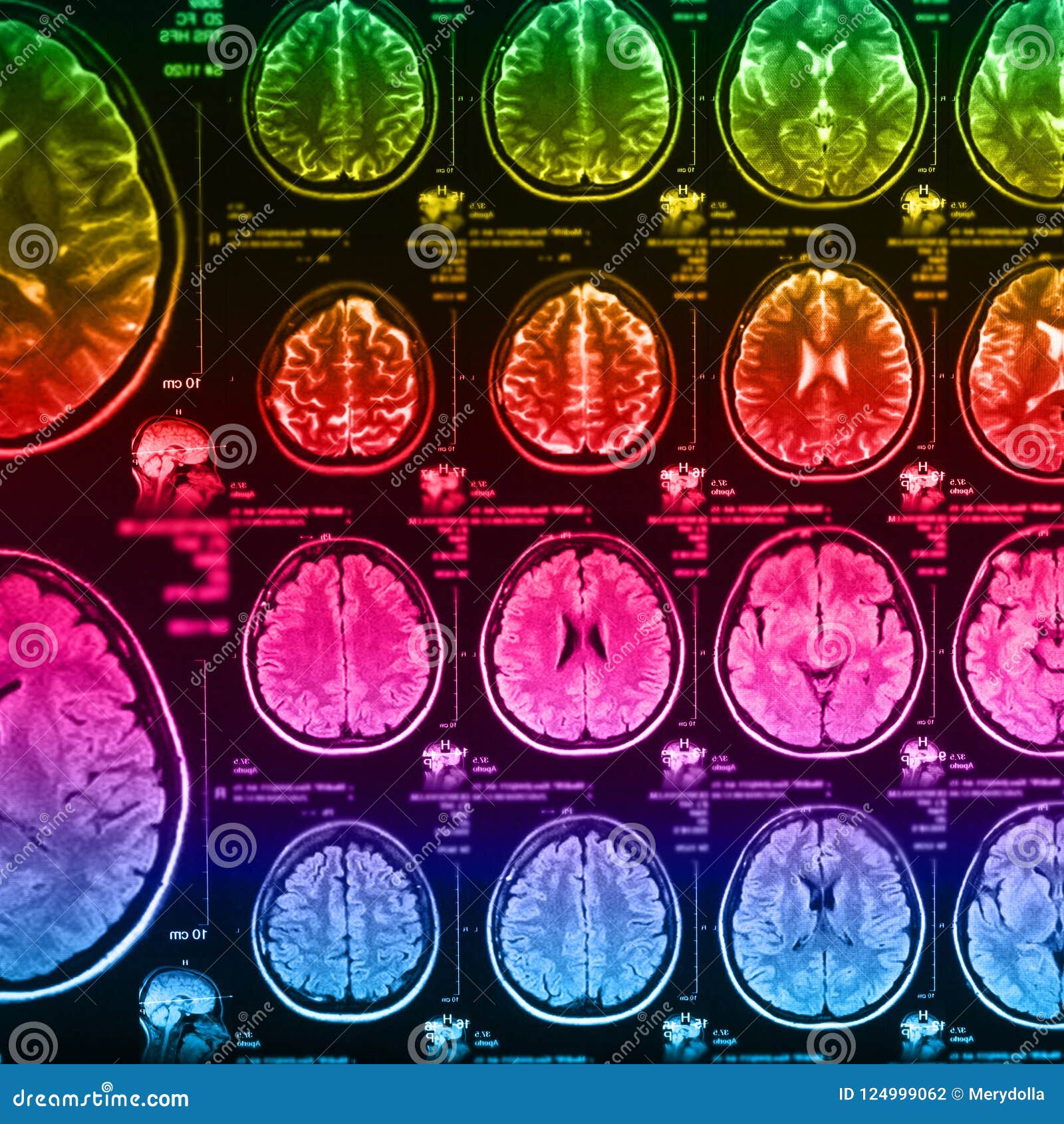 The X-ray of the Human Brain Stock Photo - Image of resonance, test ...