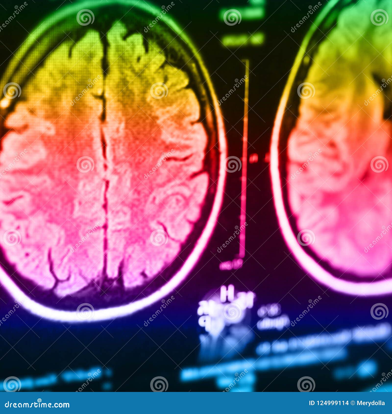 The X-ray of the Human Brain Stock Photo - Image of disease, magnetic ...
