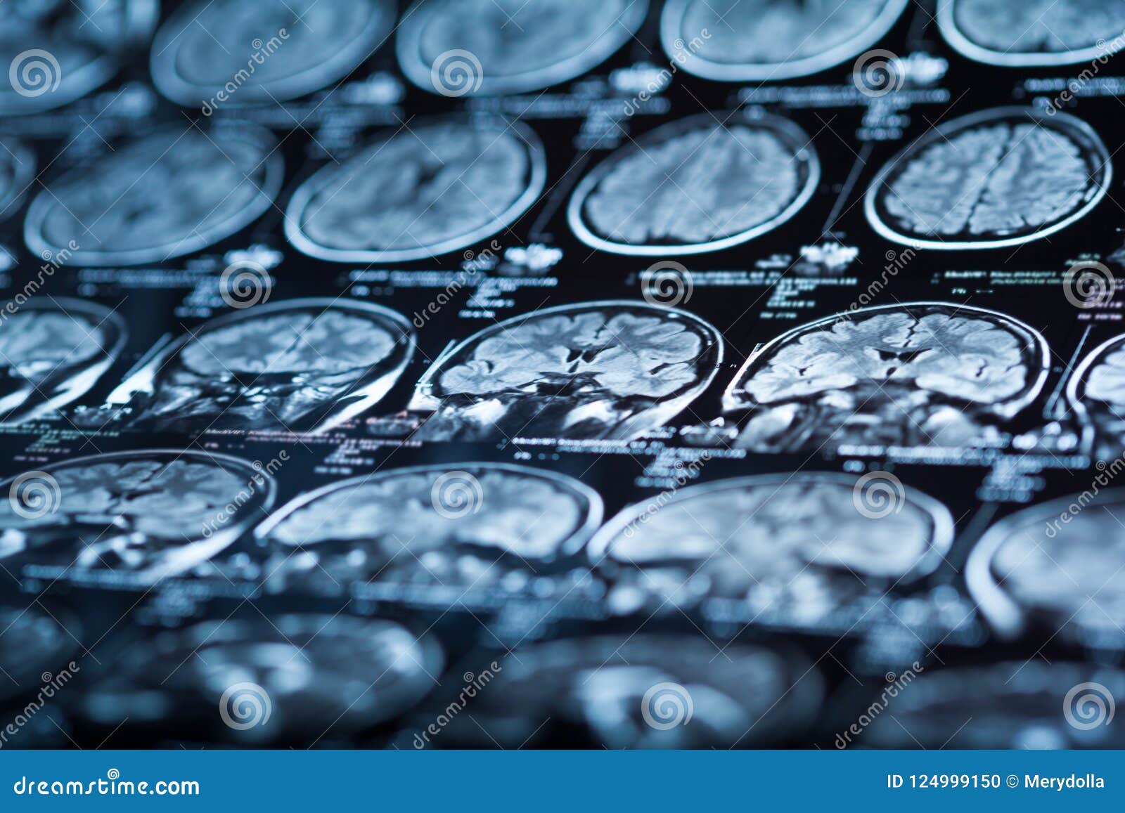 The X-ray of the Human Brain Stock Photo - Image of magnetic, brain ...
