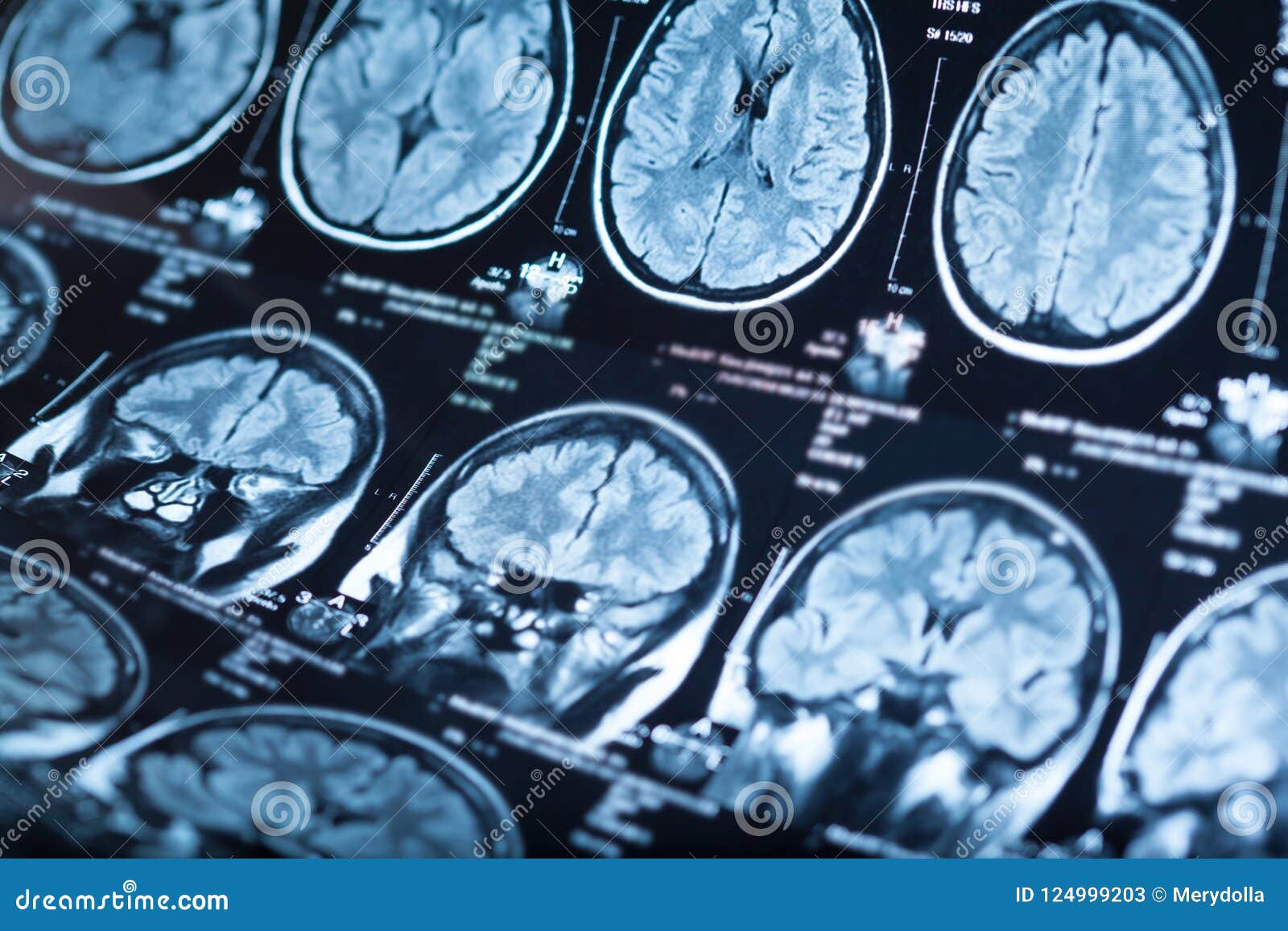 The X-ray of the Human Brain Stock Image - Image of hospital, test ...
