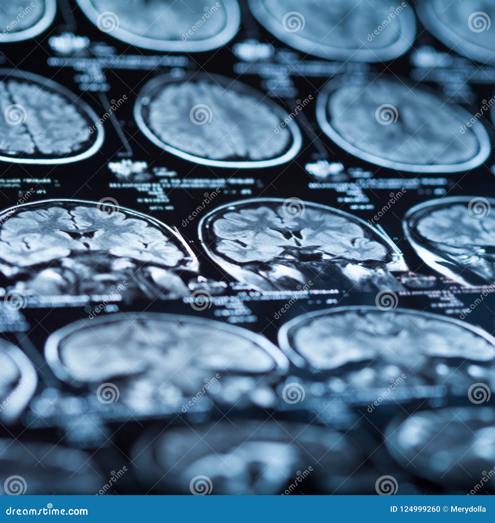 The X-ray of the Human Brain Stock Photo - Image of scan, disease ...