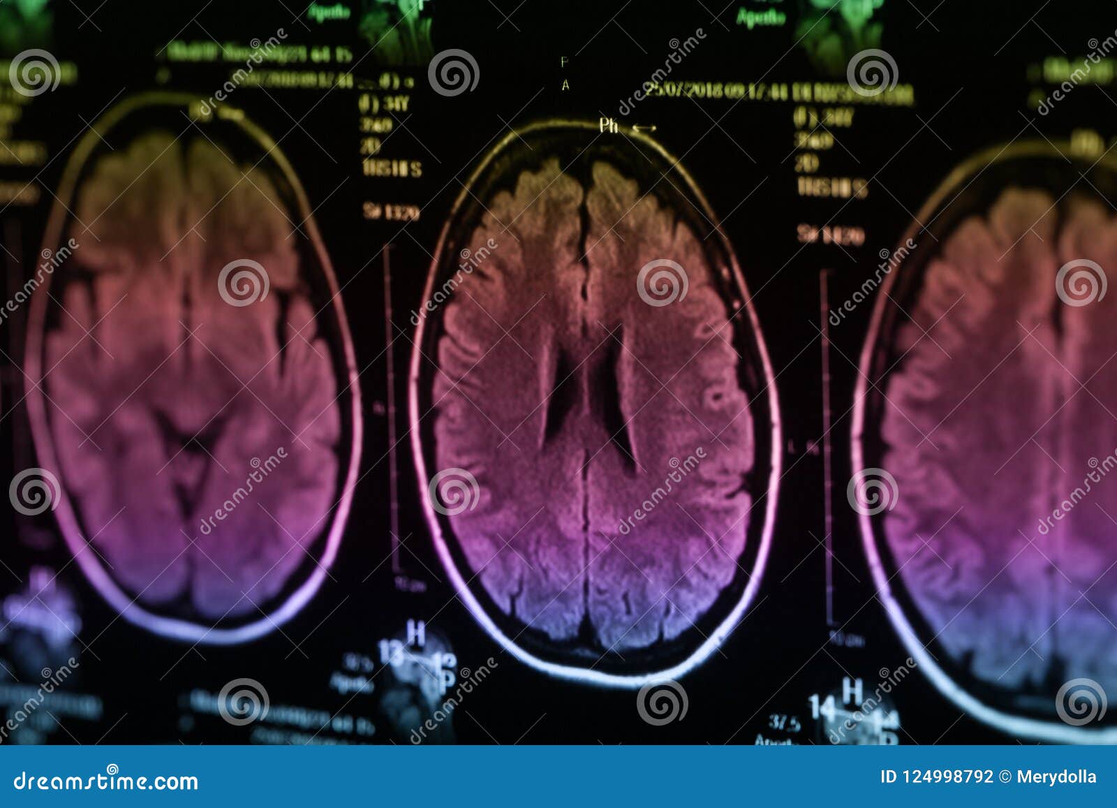 The X-ray of the Human Brain Stock Photo - Image of test, hospital ...