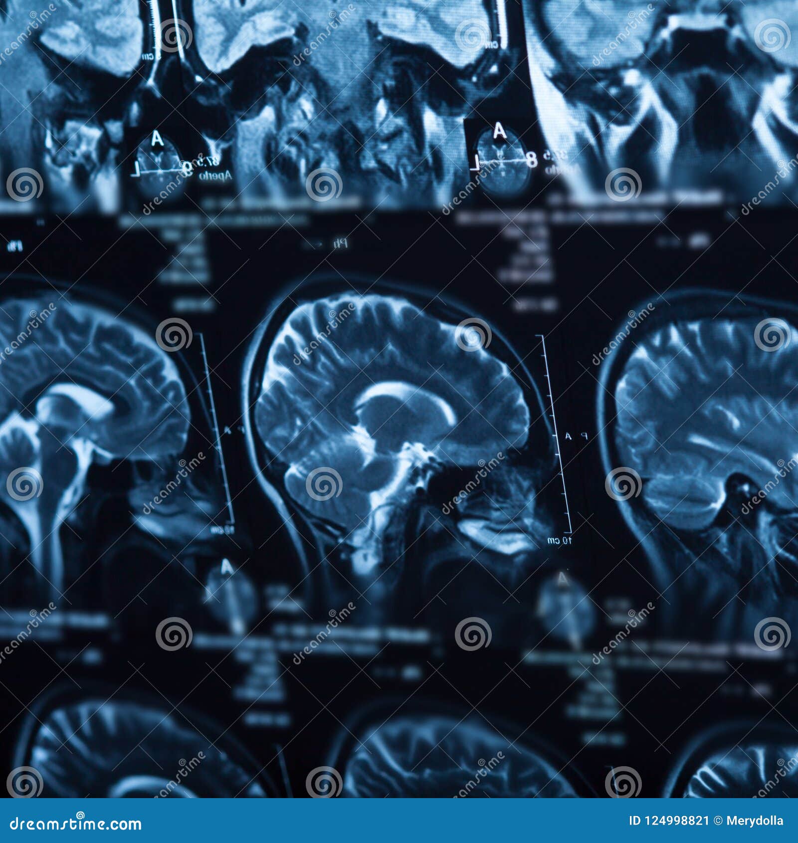 The X-ray of the Human Brain Stock Image - Image of treatment, human ...