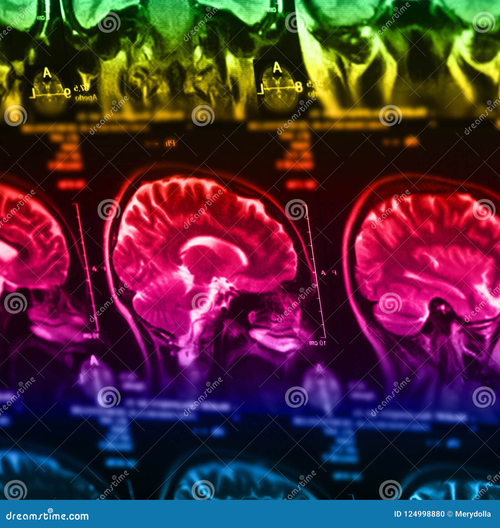 The X-ray of the Human Brain Stock Photo - Image of xray, neurology ...