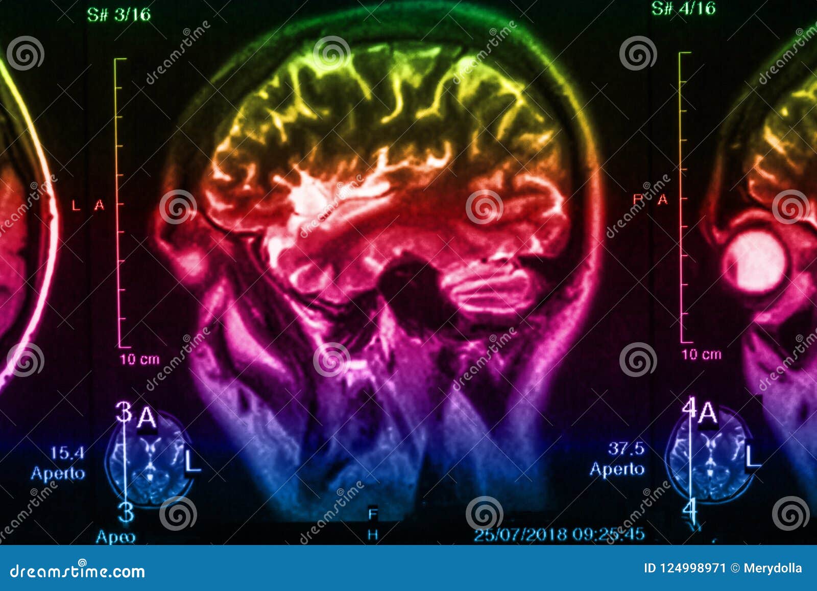 The X-ray of the Human Brain Stock Image - Image of treatment, test ...