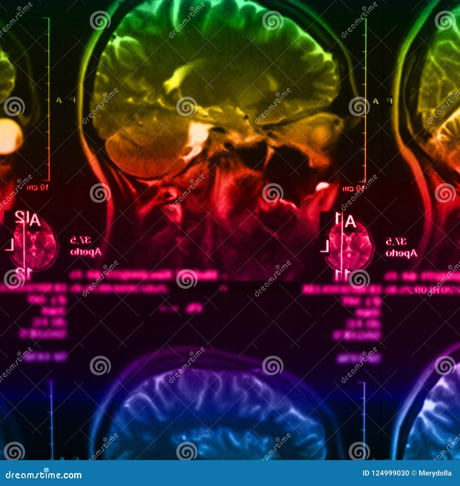 The X-ray of the Human Brain Stock Photo - Image of hospital, imaging ...