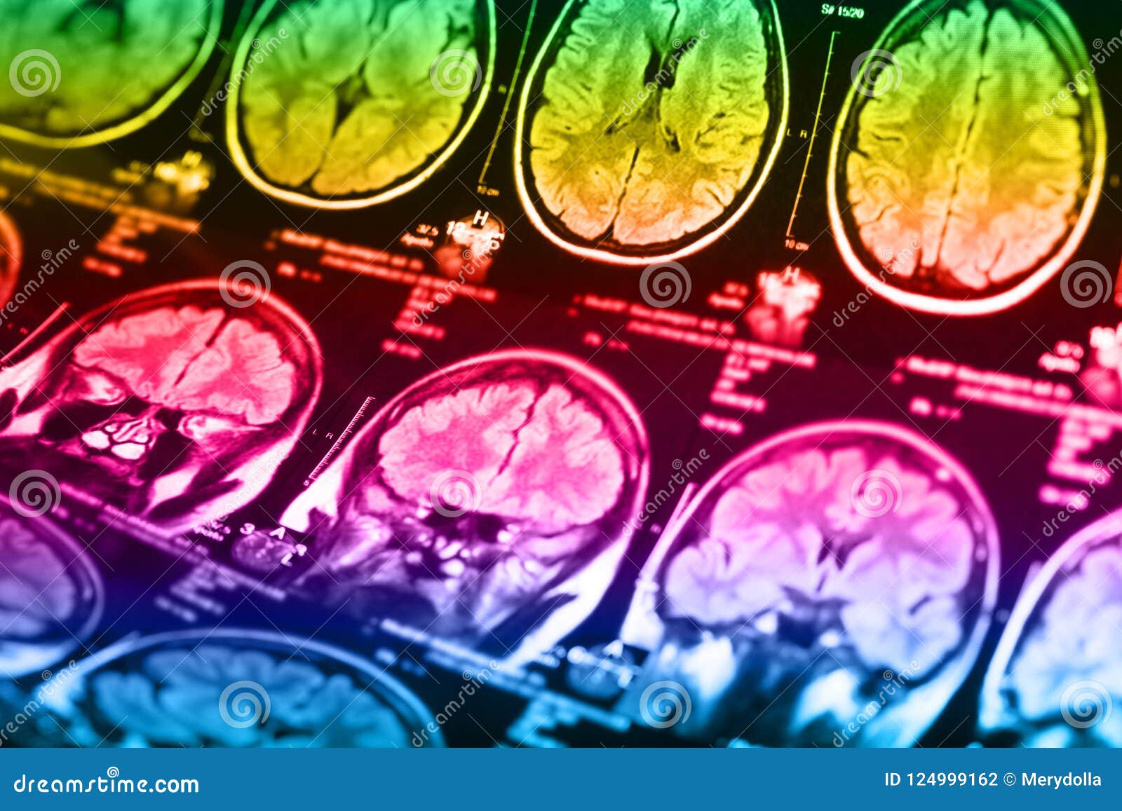 The X-ray of the Human Brain Stock Photo - Image of healthcare ...