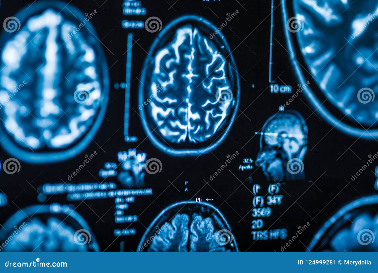 The X-ray of the Human Brain Stock Image - Image of healthcare ...