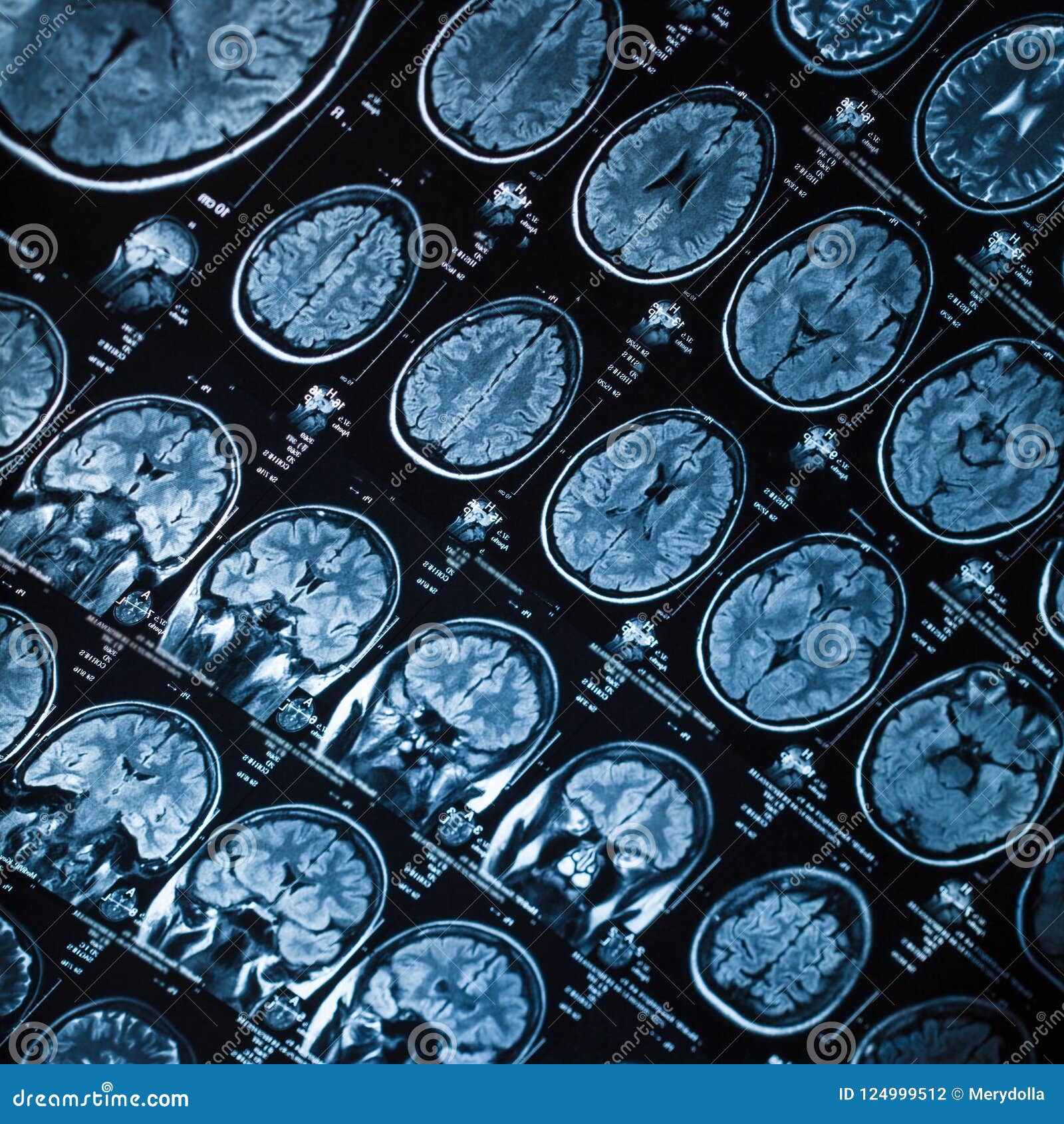 The X-ray of the Human Brain Stock Photo - Image of human, tumor: 124999512 The X-ray of the Human Brain Stock Photo - Image of human, tumor: 124999512