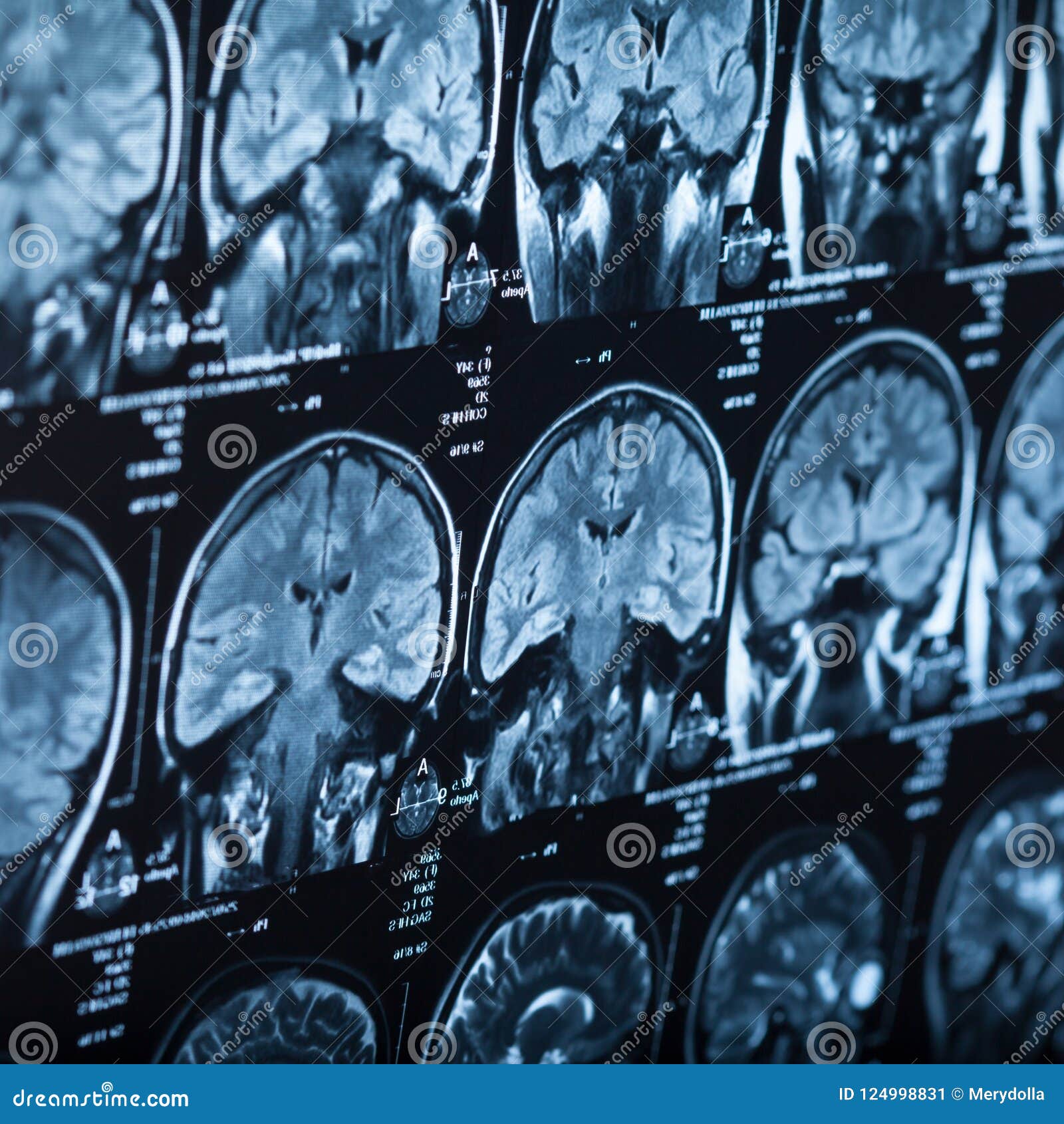 The X-ray of the Human Brain Stock Image - Image of resonance, health ...