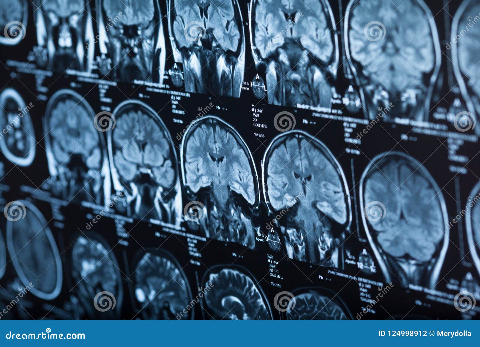 The X-ray of the Human Brain Stock Photo - Image of scan, resonance ...