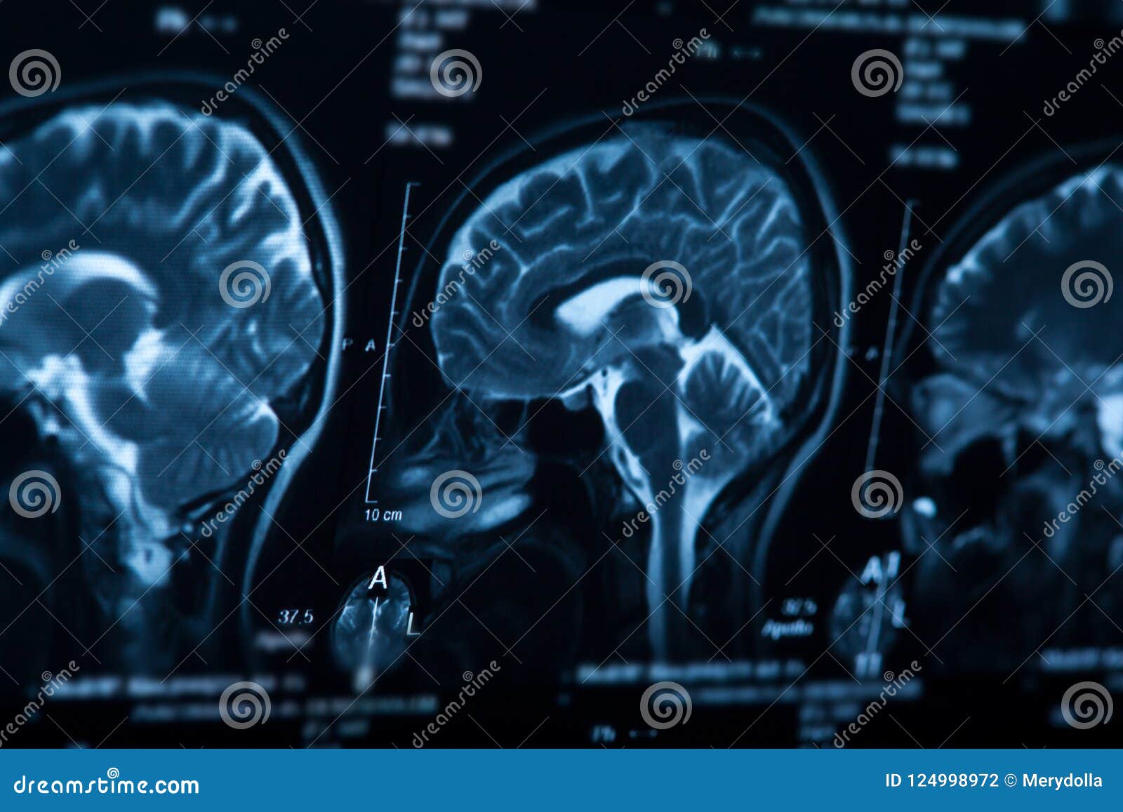 The X-ray of the Human Brain Stock Photo - Image of healthcare ...