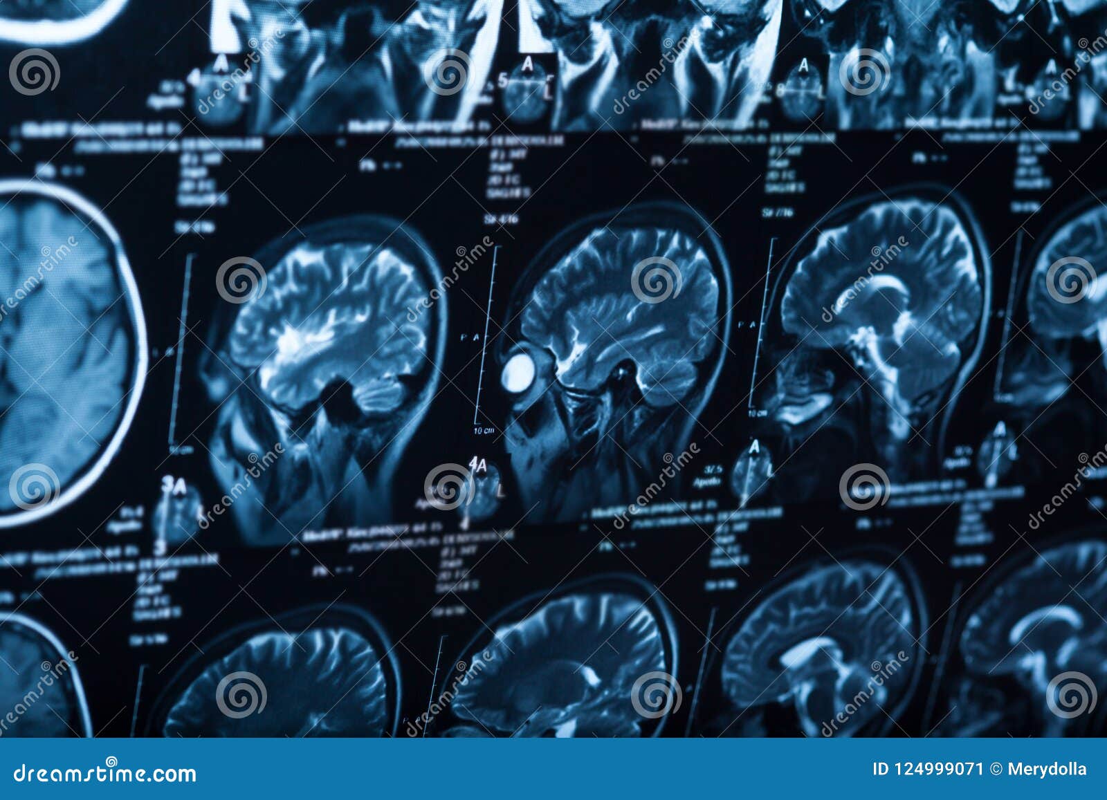 The X-ray of the Human Brain Stock Image - Image of magnetic, cancer ...