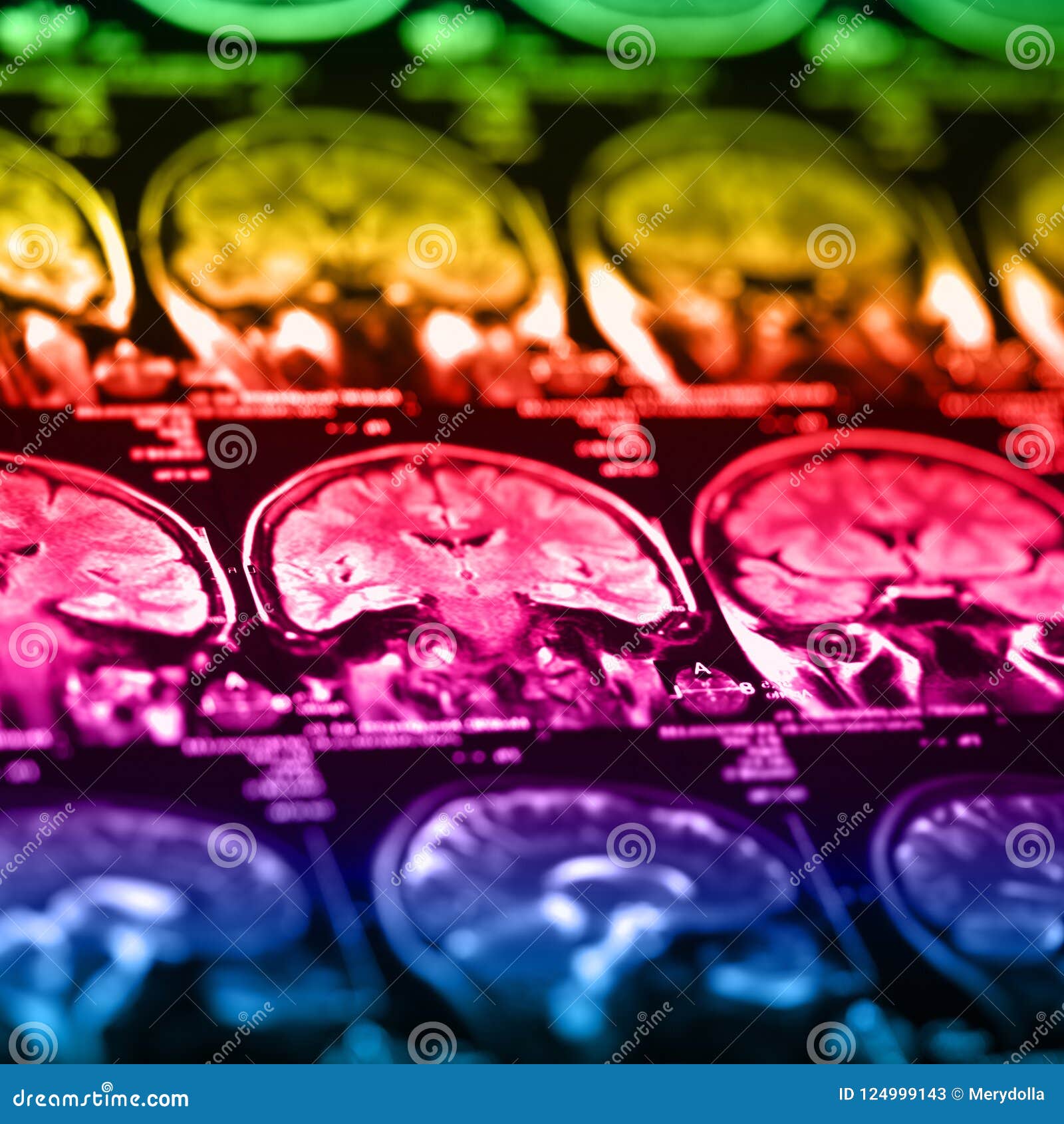 The X-ray of the Human Brain Stock Image - Image of human, imaging ...