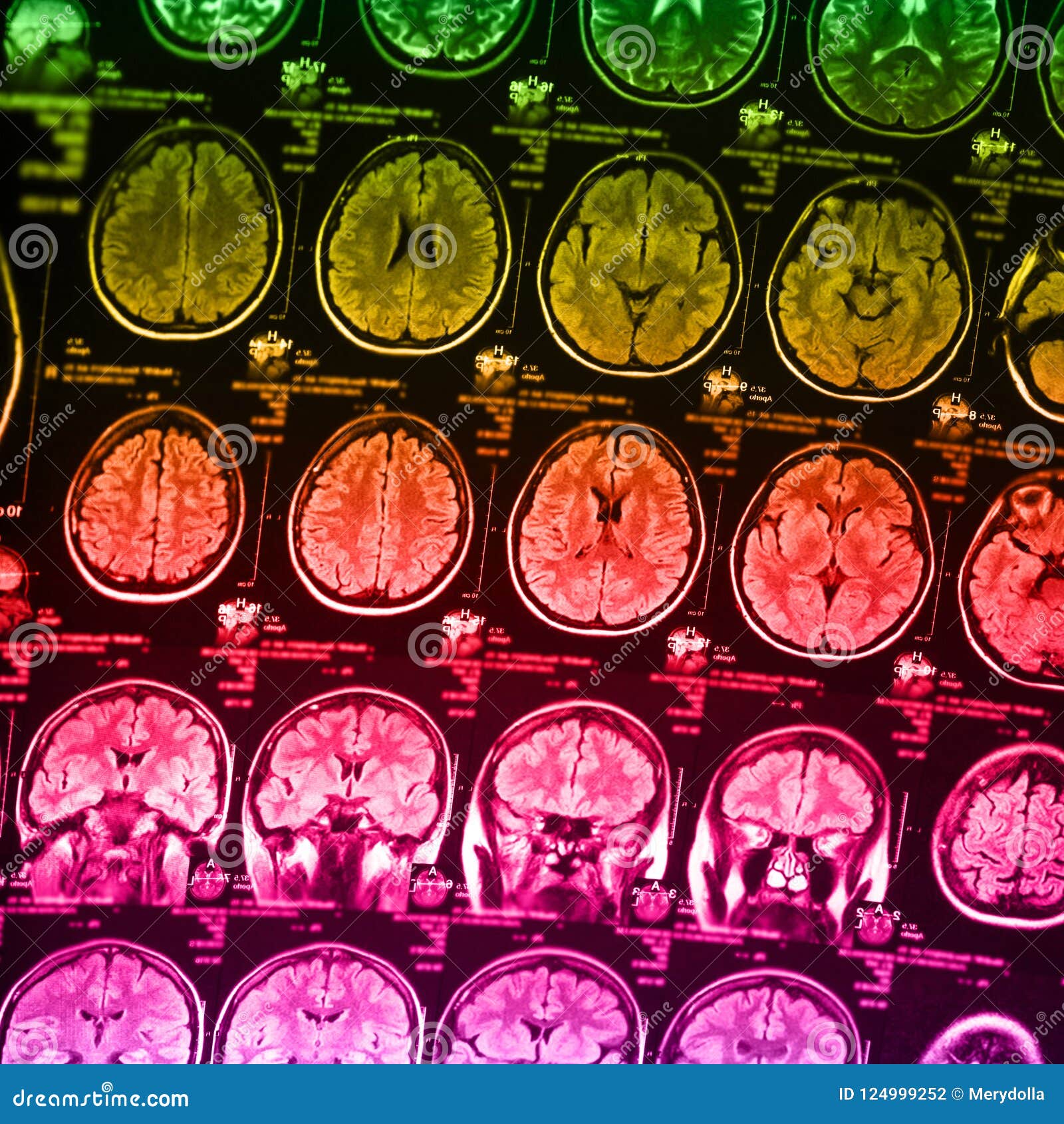 The X-ray of the Human Brain Stock Photo - Image of healthcare, disease ...