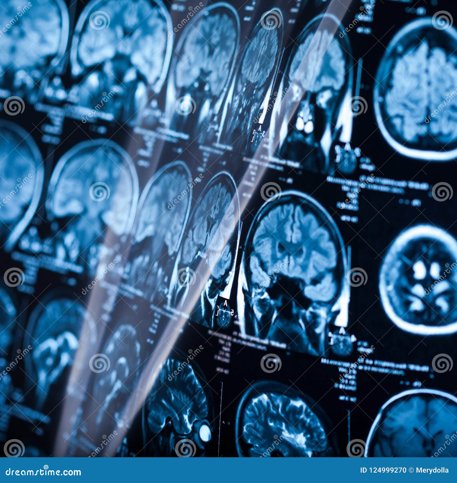 The X-ray of the Human Brain Stock Photo - Image of magnetic, tumor ...