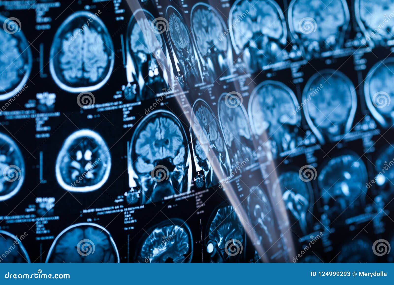 The X-ray of the Human Brain Stock Image - Image of health, radiology ...