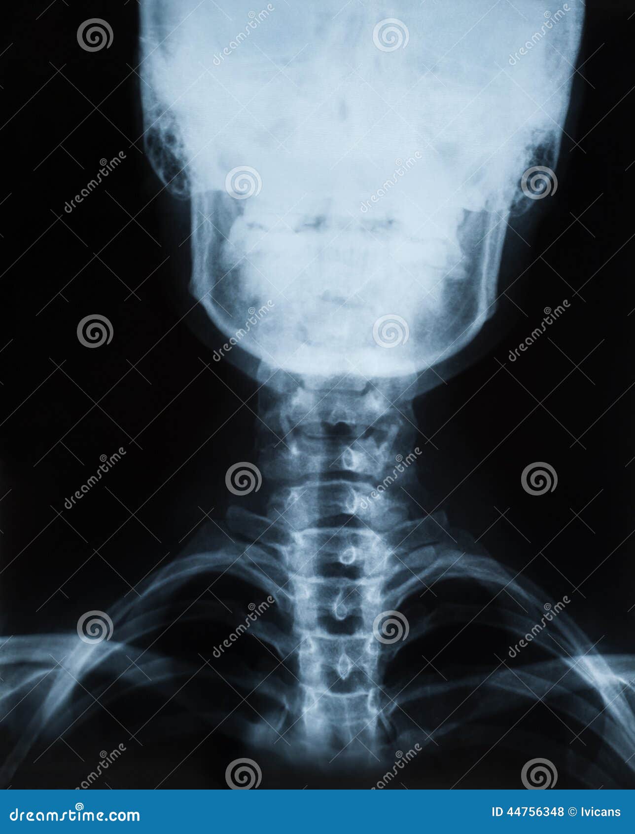 X-ray of Human Cervical Spine Stock Photo - Image of neck, spinal: 44756348