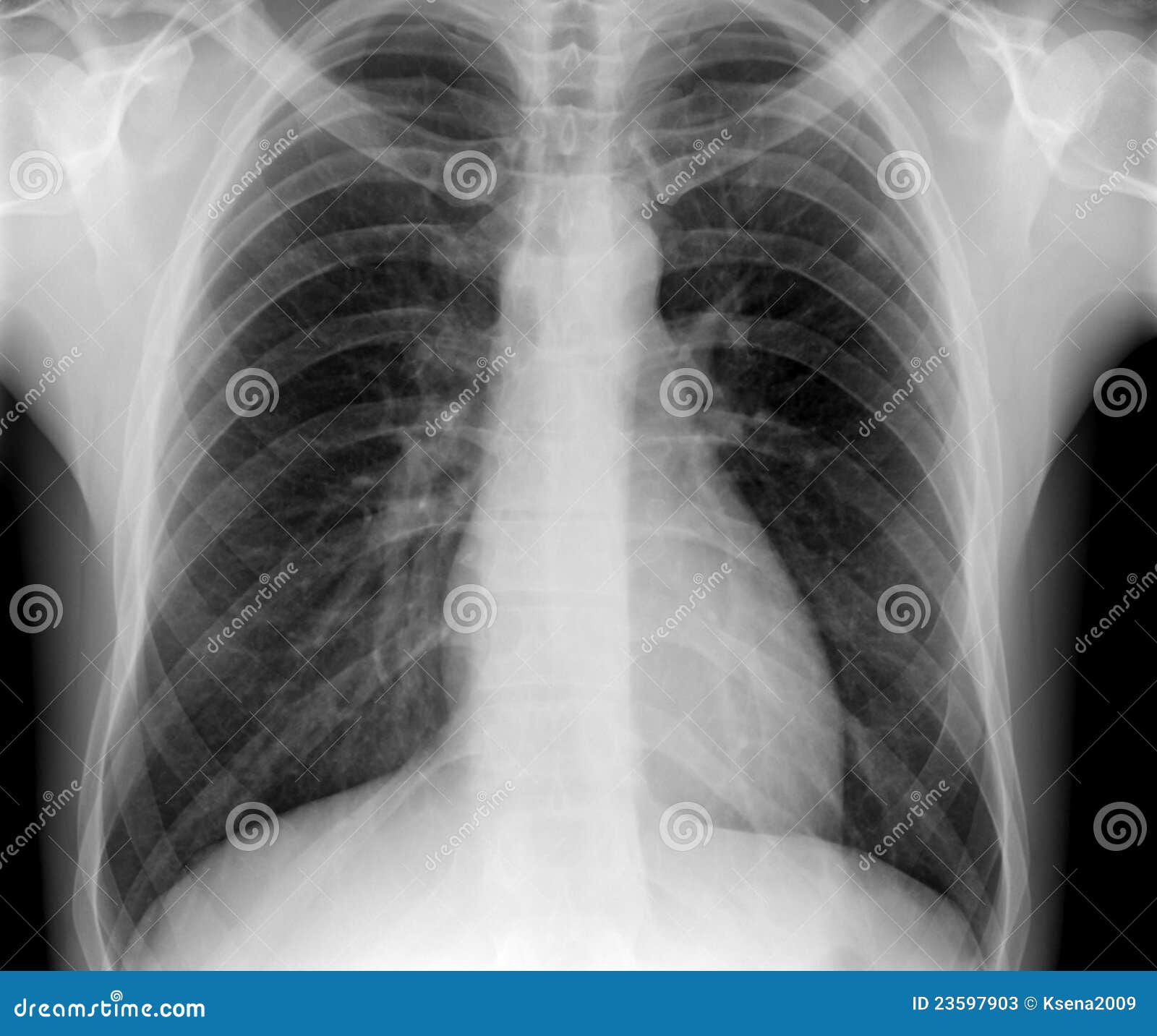 X-ray of human chest stock image. Image of lungs, human - 23597903