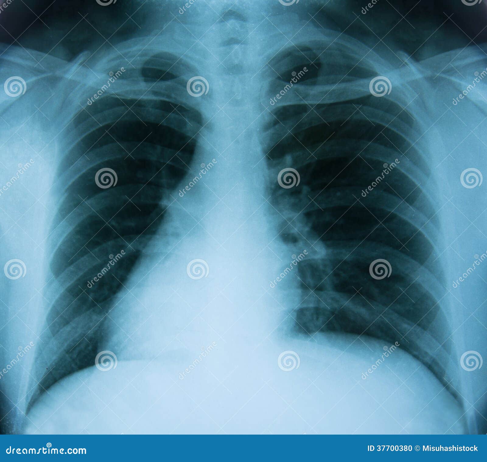 X-Ray of Human Chest stock photo. Image of laboratory - 37700380