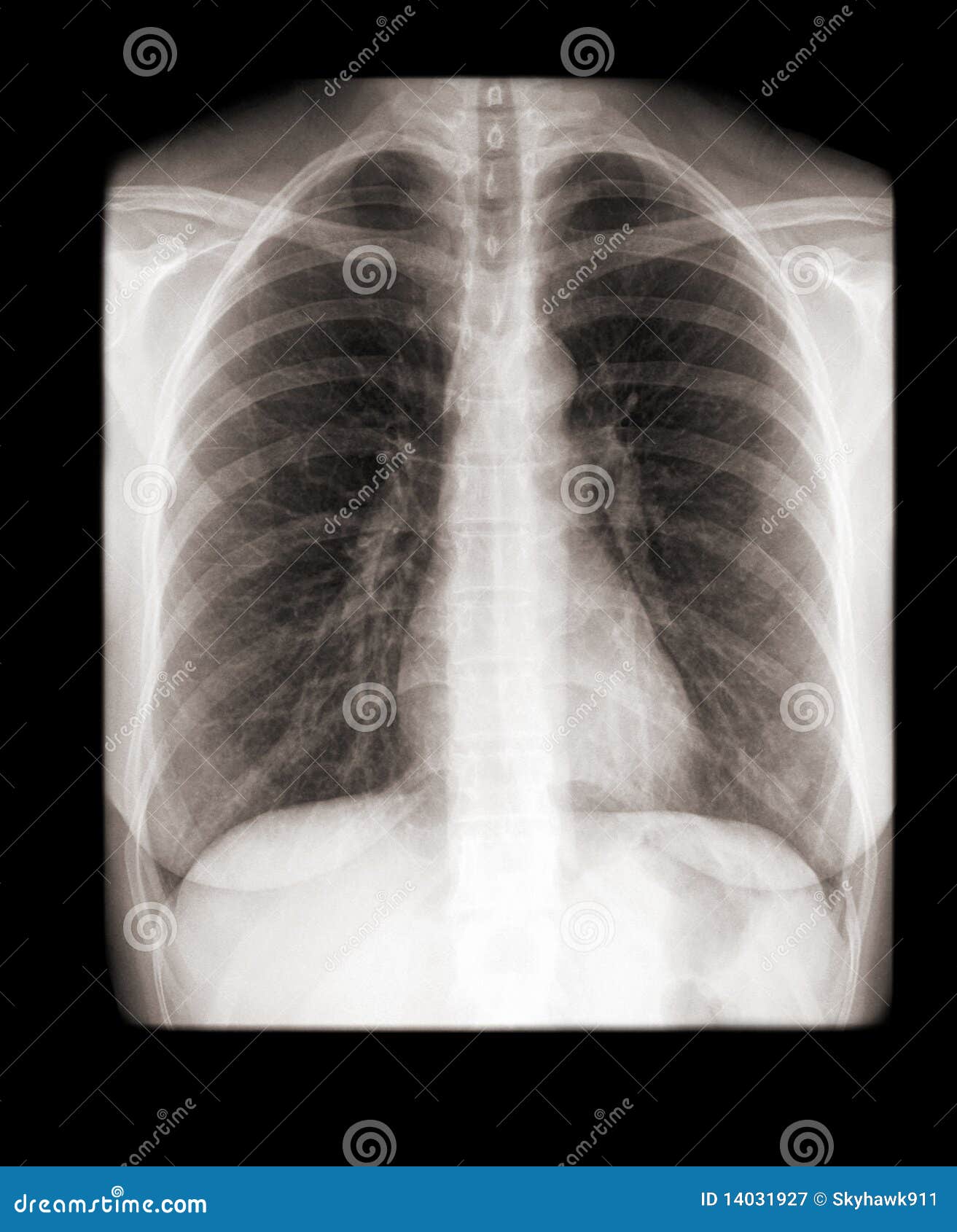 X-ray Of A Human Chest Front View Royalty Free Stock Photography ...