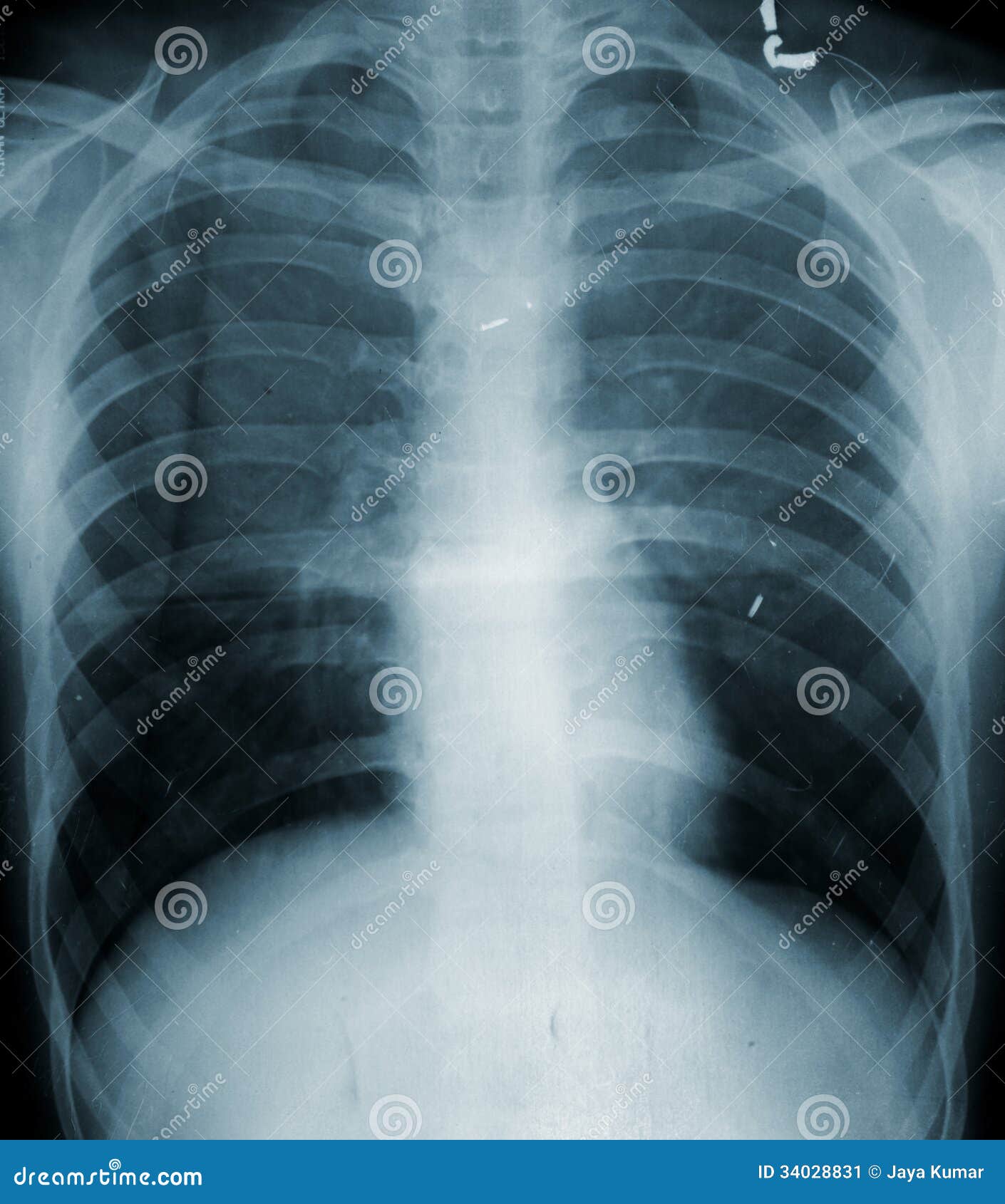 X-Ray Human Chest Stock Image - Image: 34028831