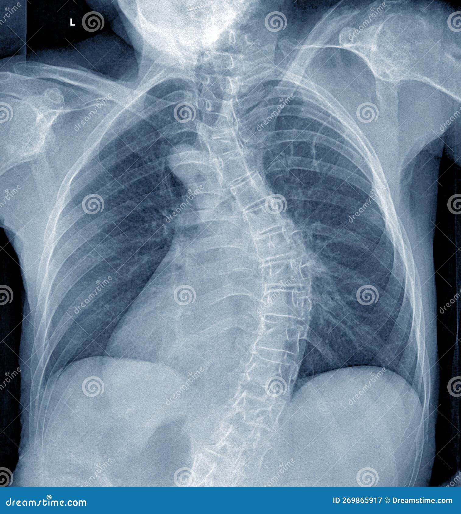 X-ray of the Human Chest Organs, C-shaped Scoliotic Deformity of the ...