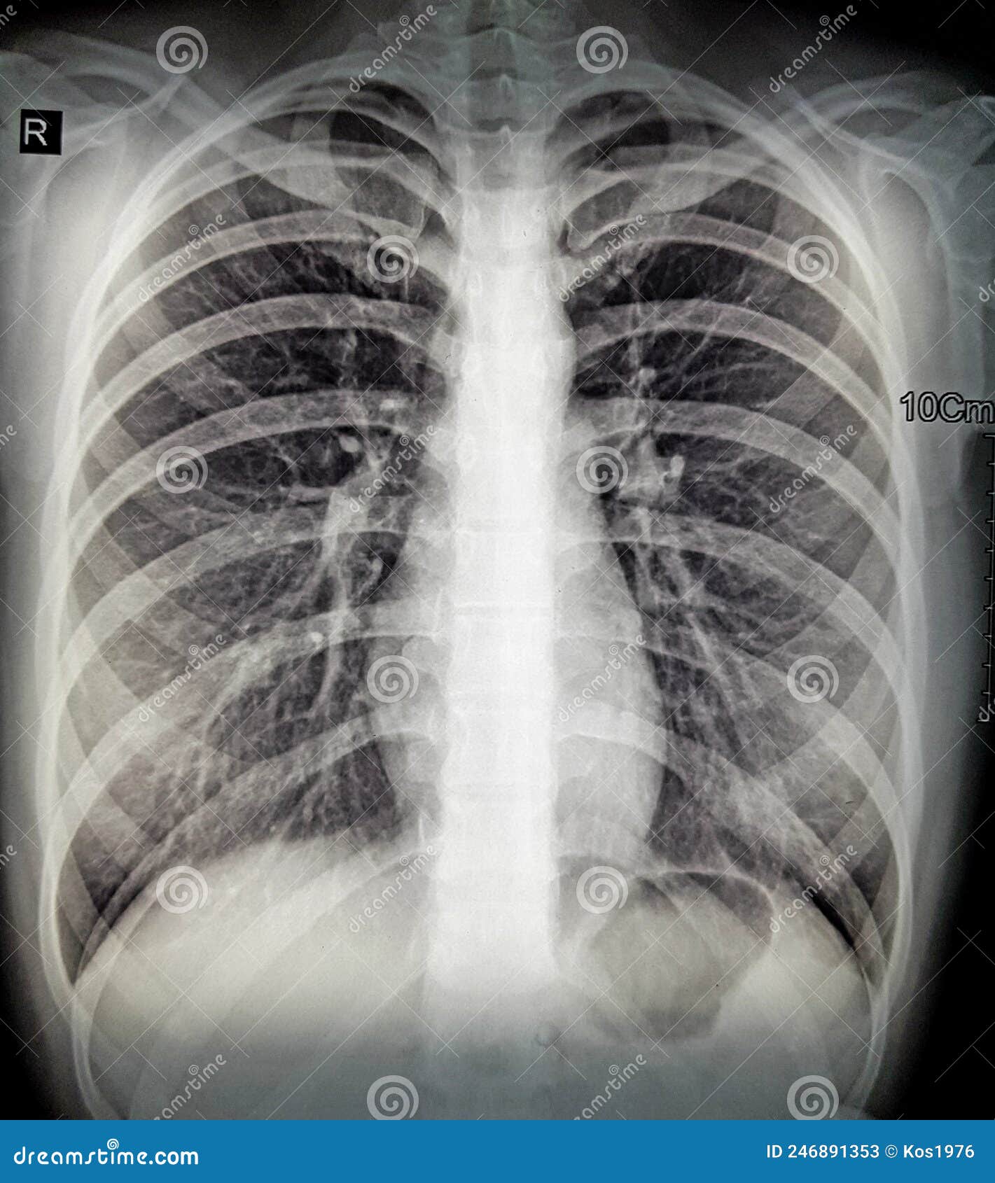 X-ray of the human chest stock image. Image of disease - 246891353