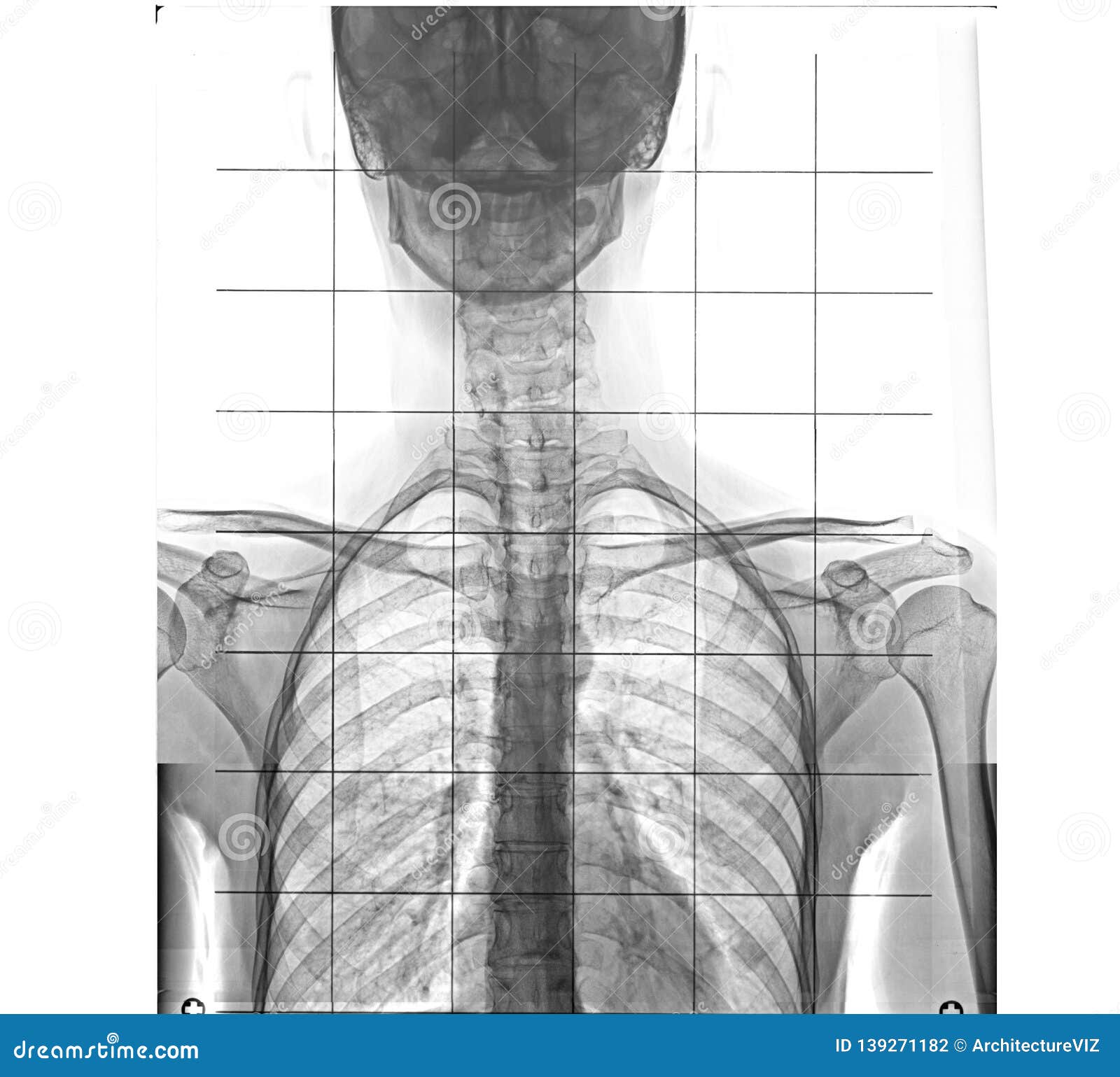 X-ray of Human Chest and Spinal Column, Front View Stock Photo - Image ...