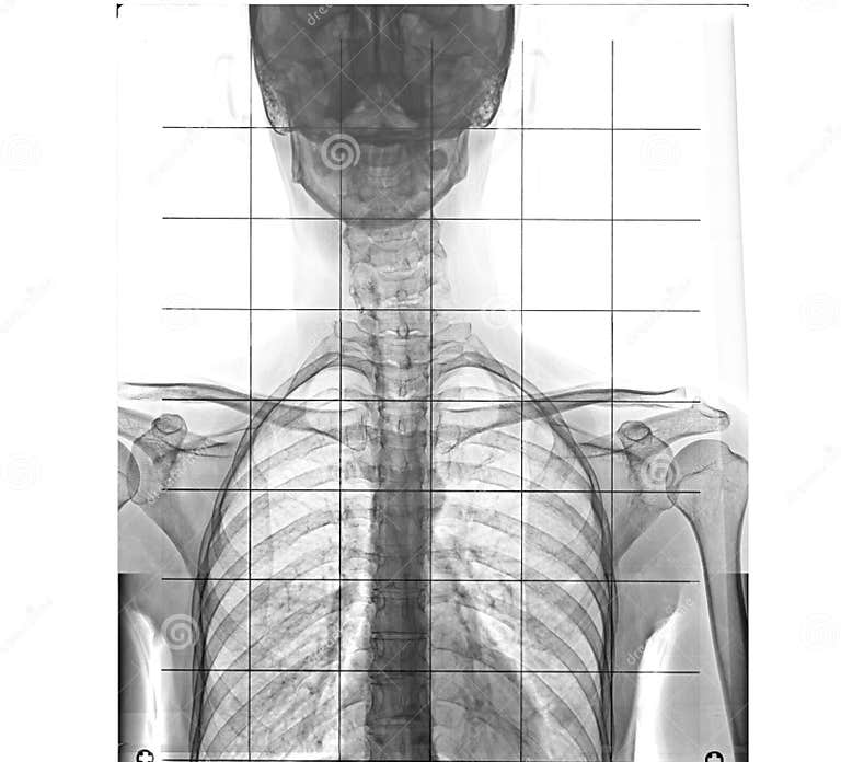 X-ray of Human Chest and Spinal Column, Front View Stock Photo - Image ...