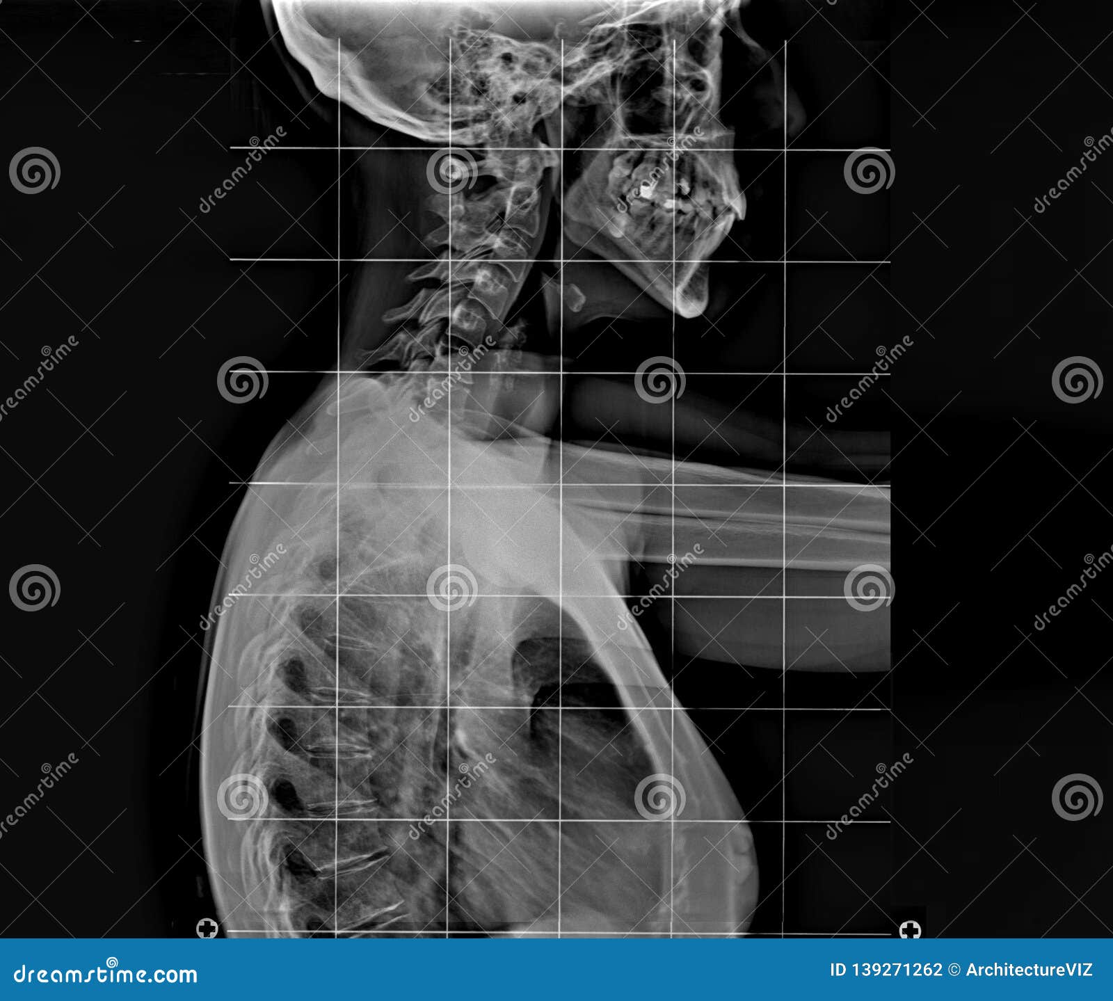 X-ray of Human Chest and Spinal Column, Side View Stock Photo - Image ...