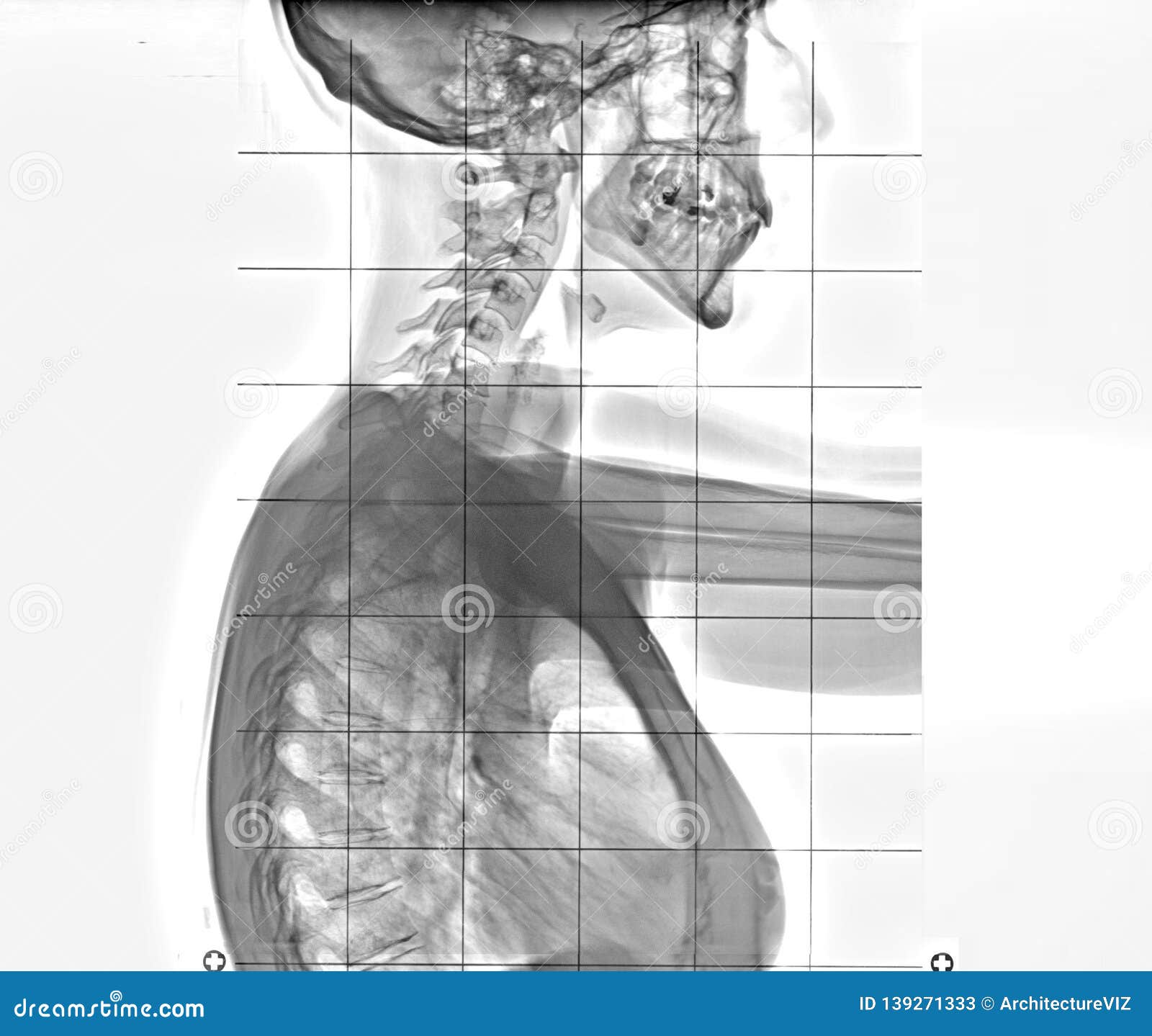 X-ray of Human Chest and Spinal Column, Side View Stock Image - Image ...