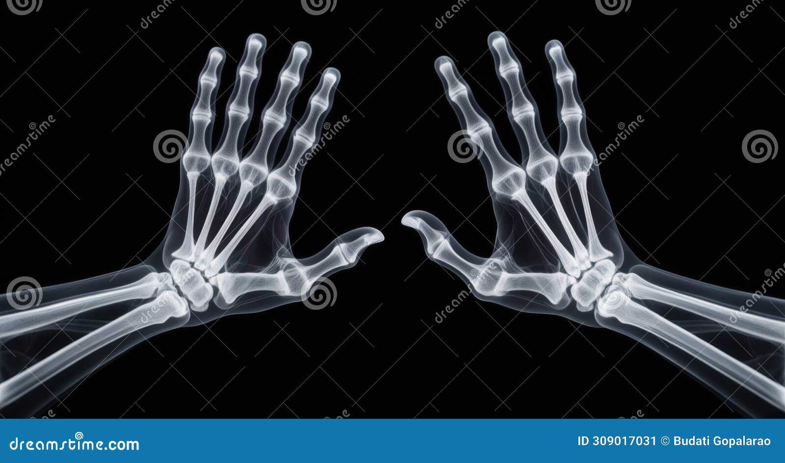 An X-ray of a Human Hand, Showcasing Its Intricate Skeletal Structure ...