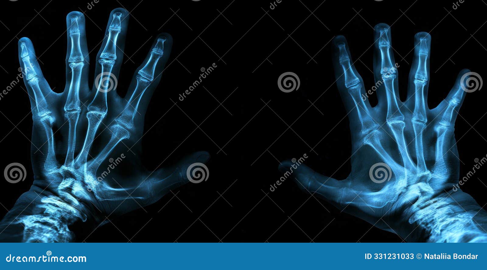 X-ray of Human Hands. Bone Structure Medical Illustration Stock Image ...