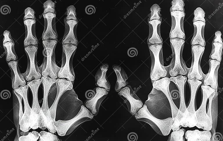 X-ray of Human Hands Displaying Intricate Bone Structure and Joint ...