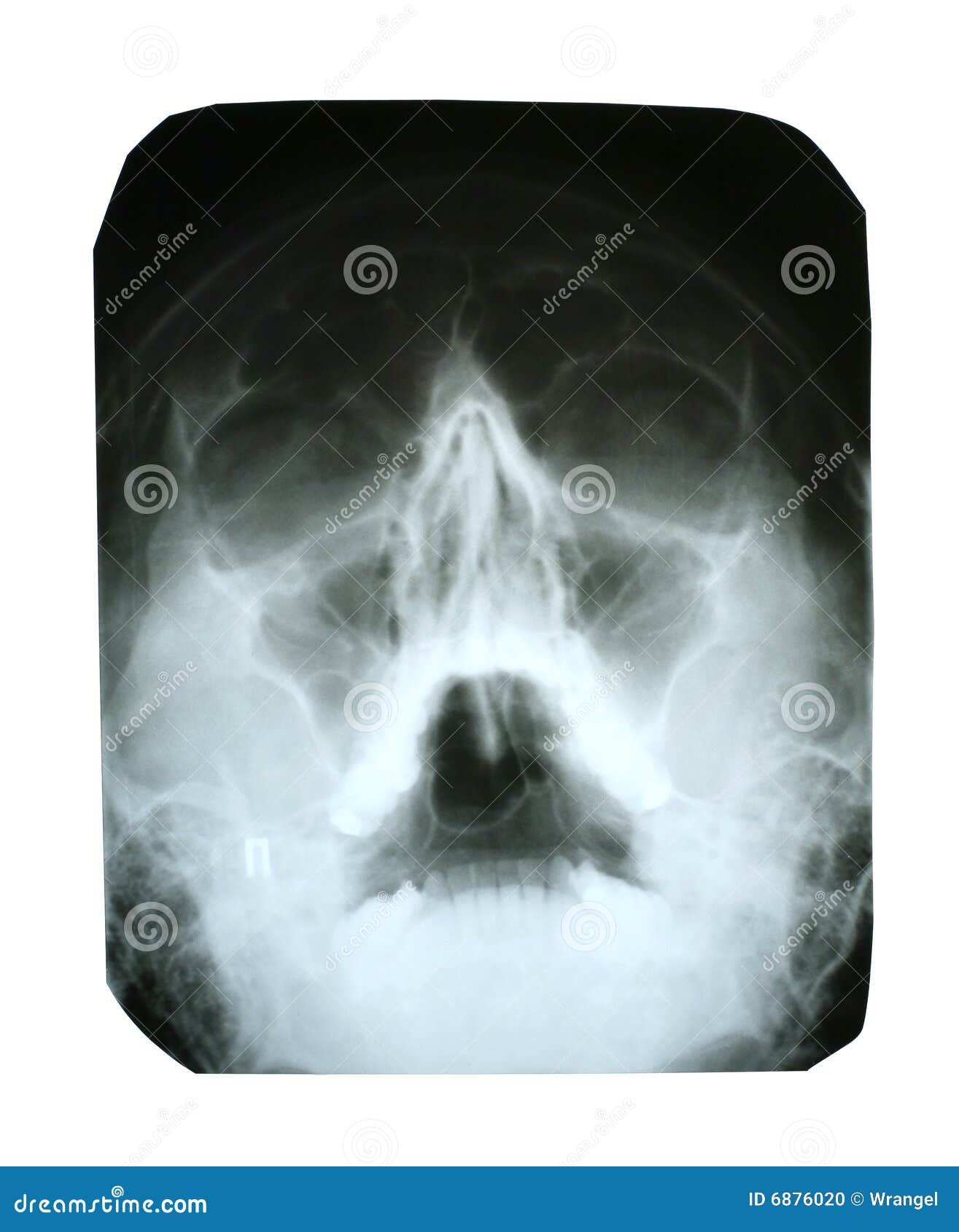 X-ray of Human Head stock photo. Image of human, dental - 6876020