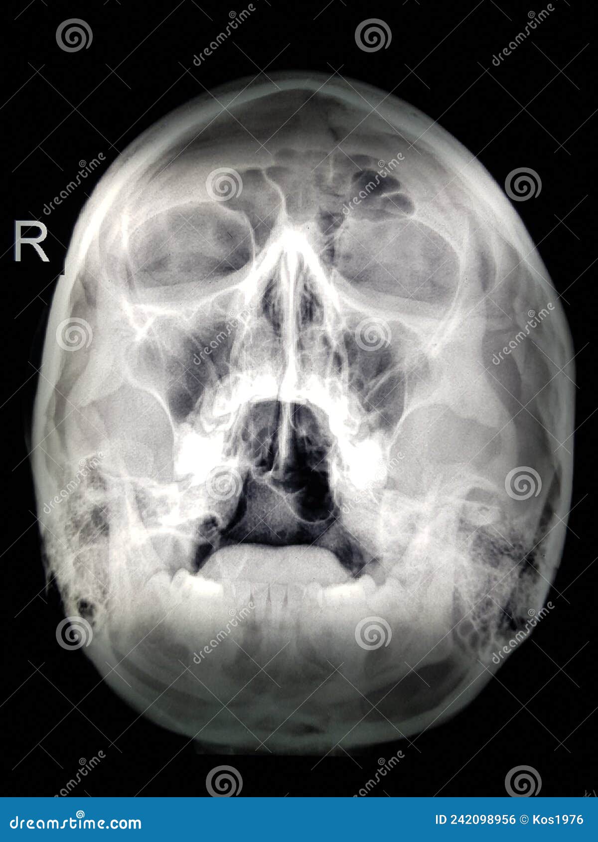 X-ray of a human head stock photo. Image of head, anatomy - 242098956