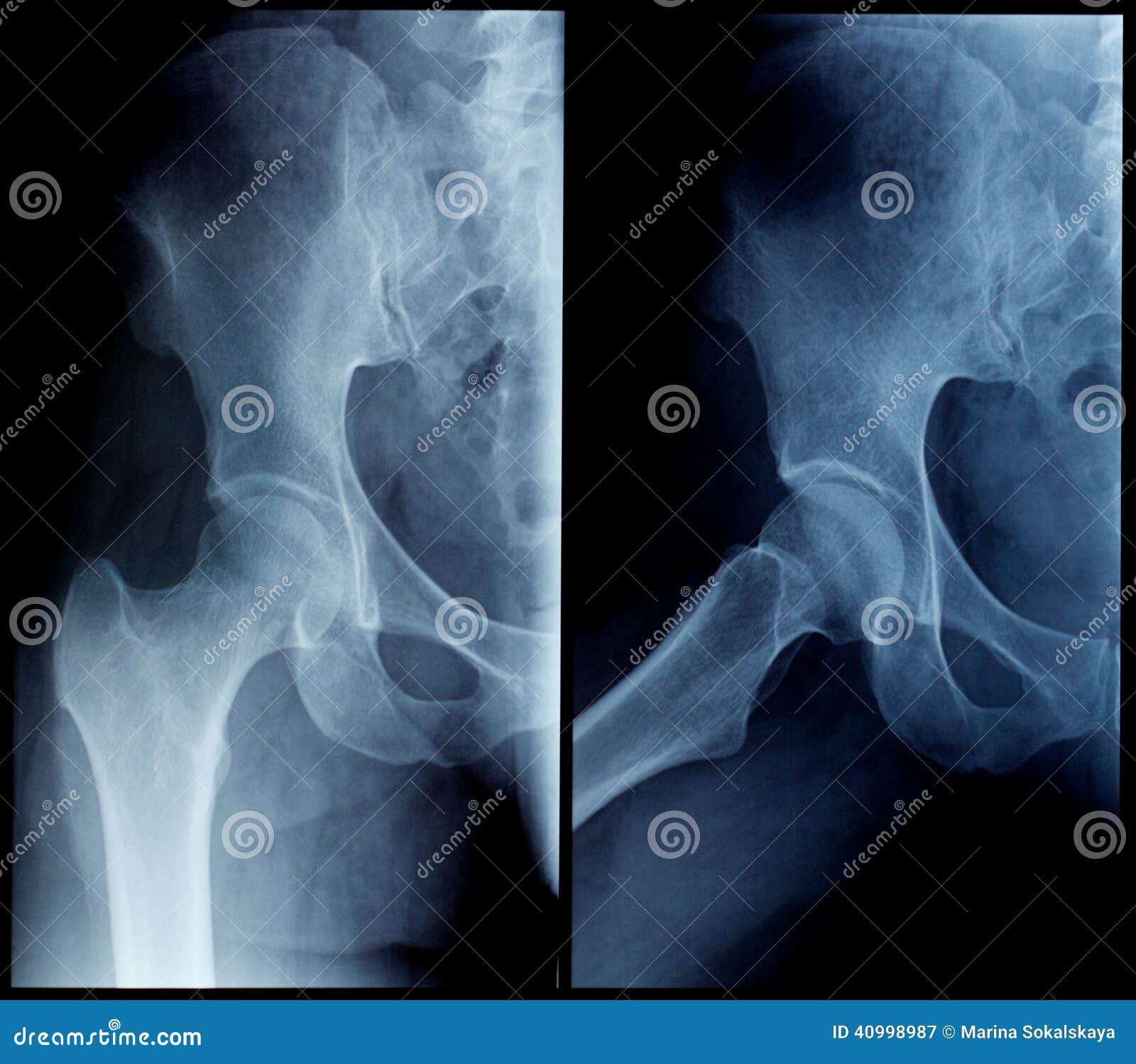 X-Ray human hip stock image. Image of coxal, health, cavity - 40998987