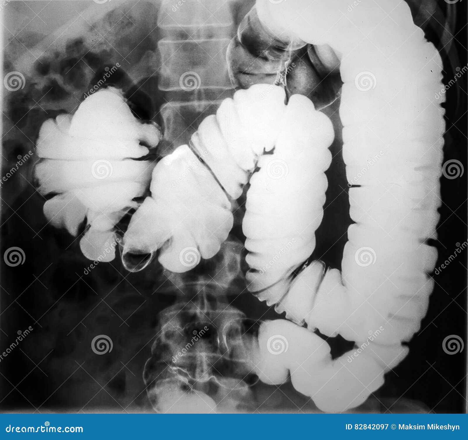 X-ray of the Human Intestine Stock Image - Image of hospital, equipment ...