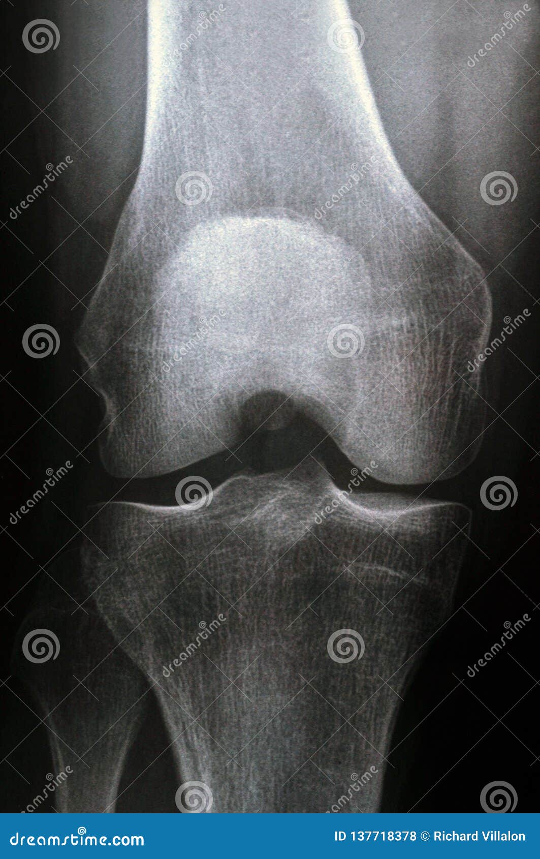 X-ray of a human knee stock photo. Image of close, xray - 137718378