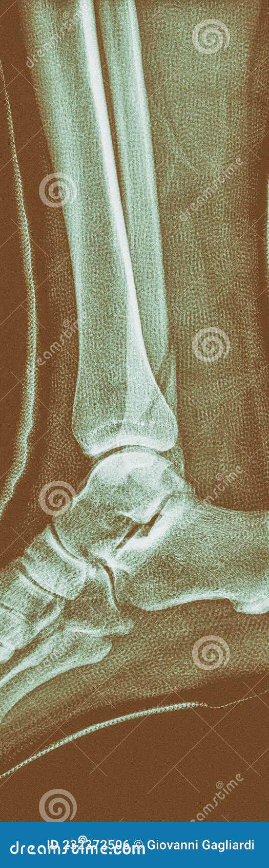 X-ray of Human Left Foot. Lateral View Stock Photo - Image of injury ...