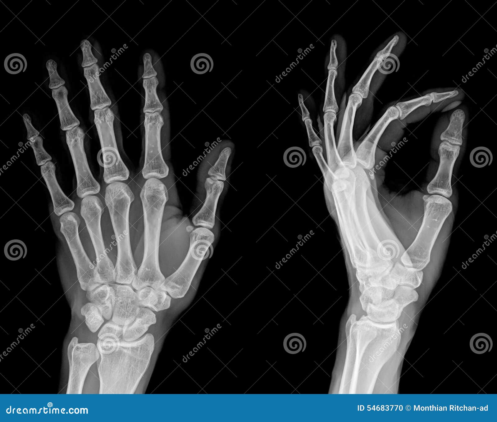 Right Hand X Ray